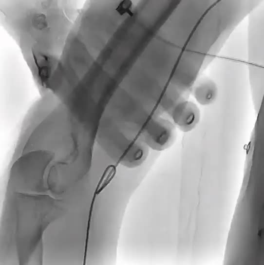 Just tap it out. | Scrolller