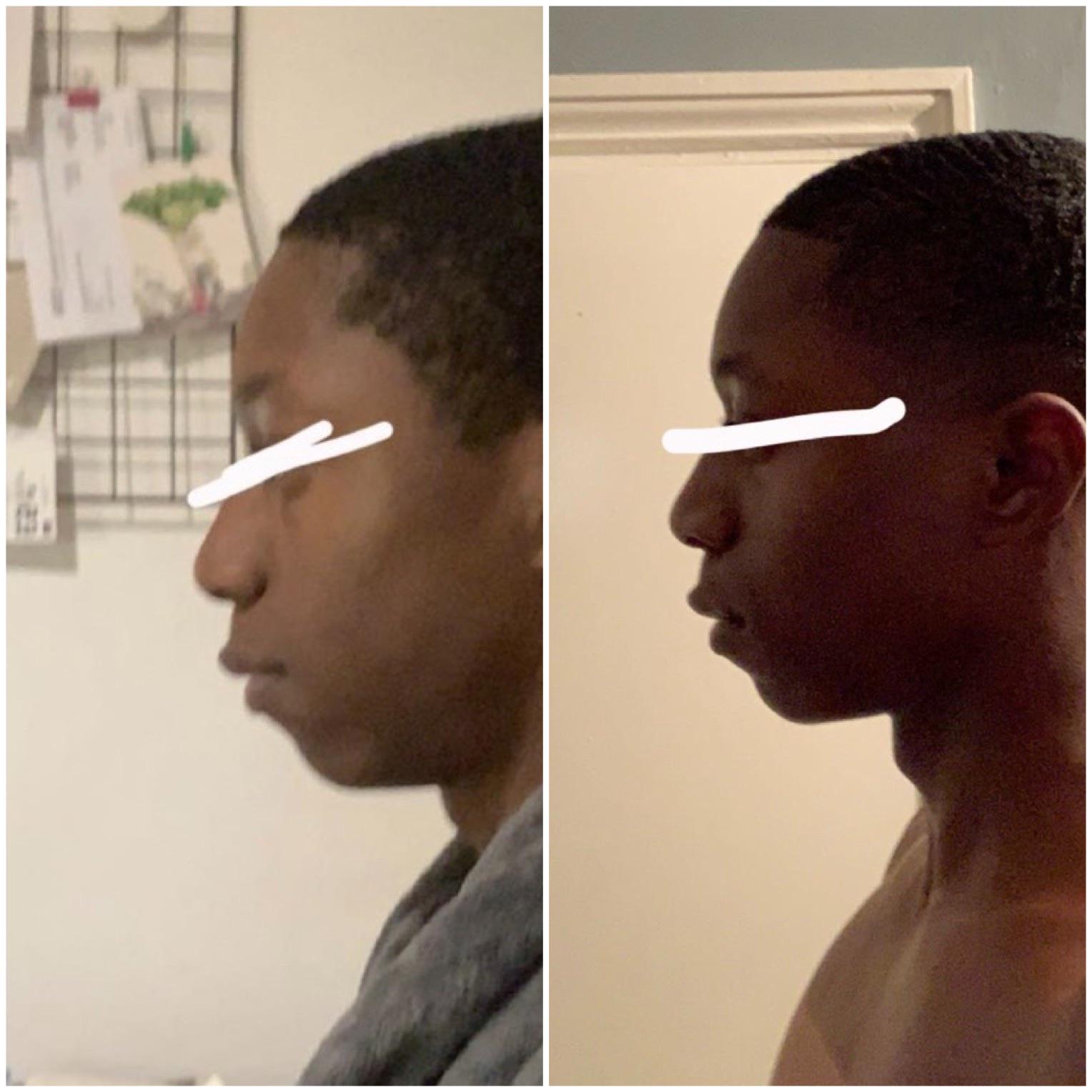 Mewing 3 months 17Y/O | Scrolller