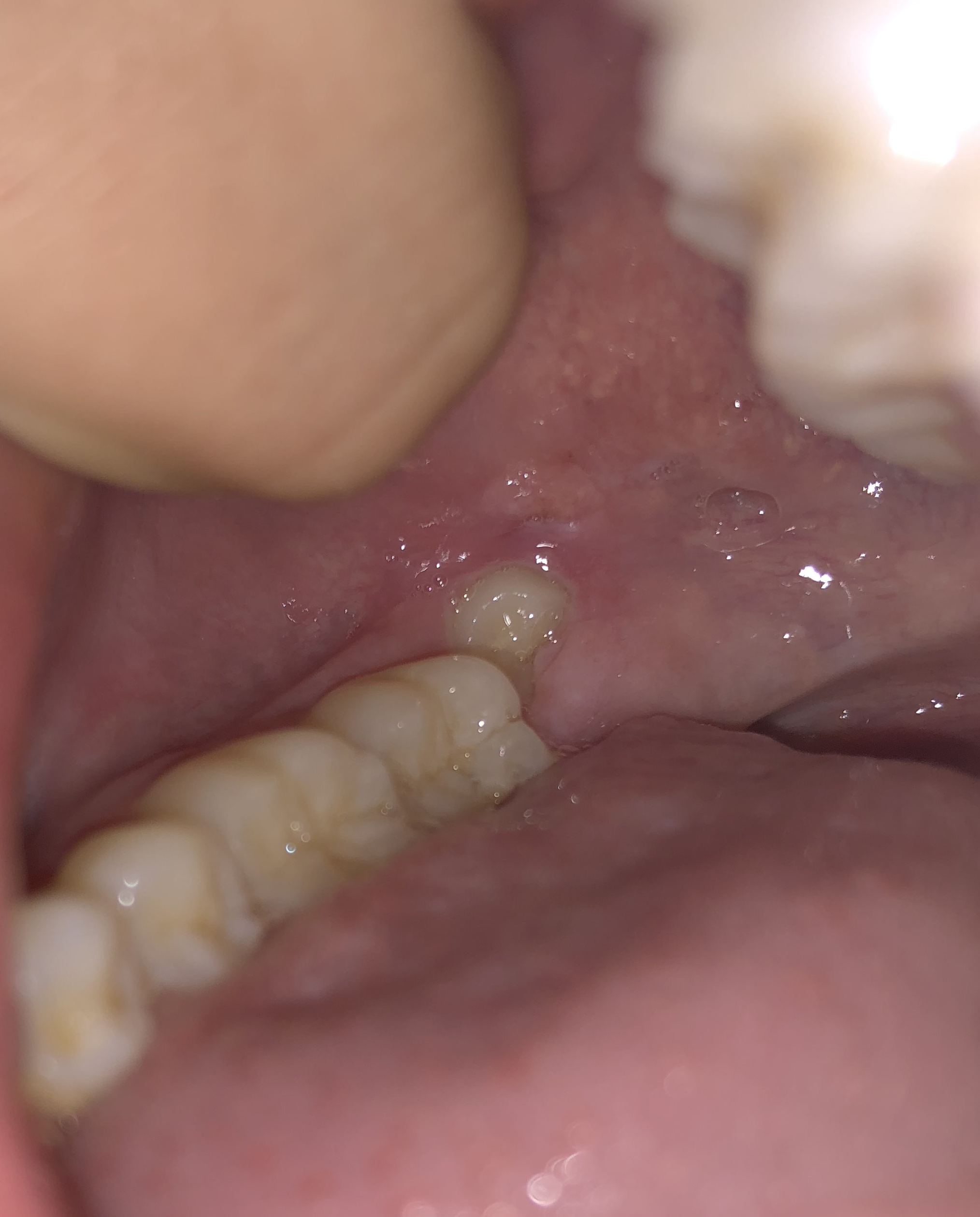 My wisdom tooth stabbing my cheek | Scrolller