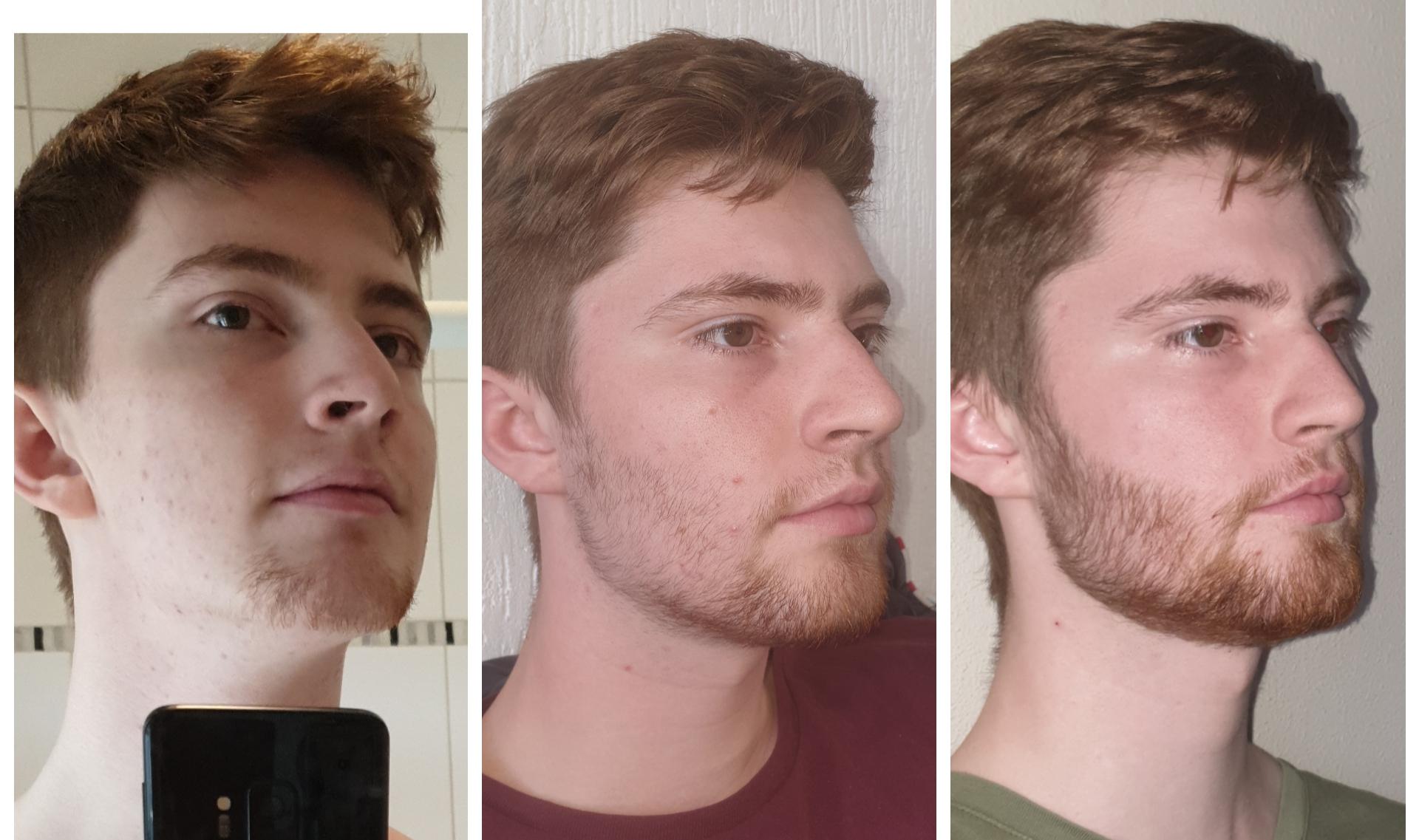 No minox (2 week growth) => 2 month's on minox (2 week growth) => almost 3 month's on minox (3 ...