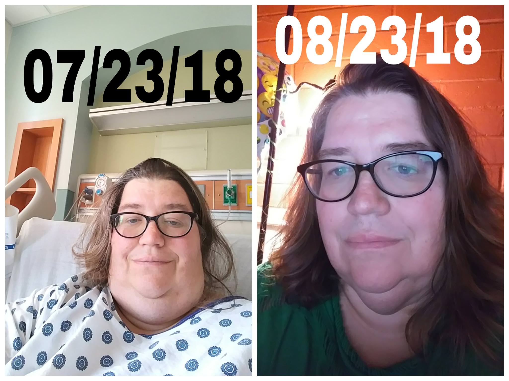 One month post op (progress pic) | Scrolller