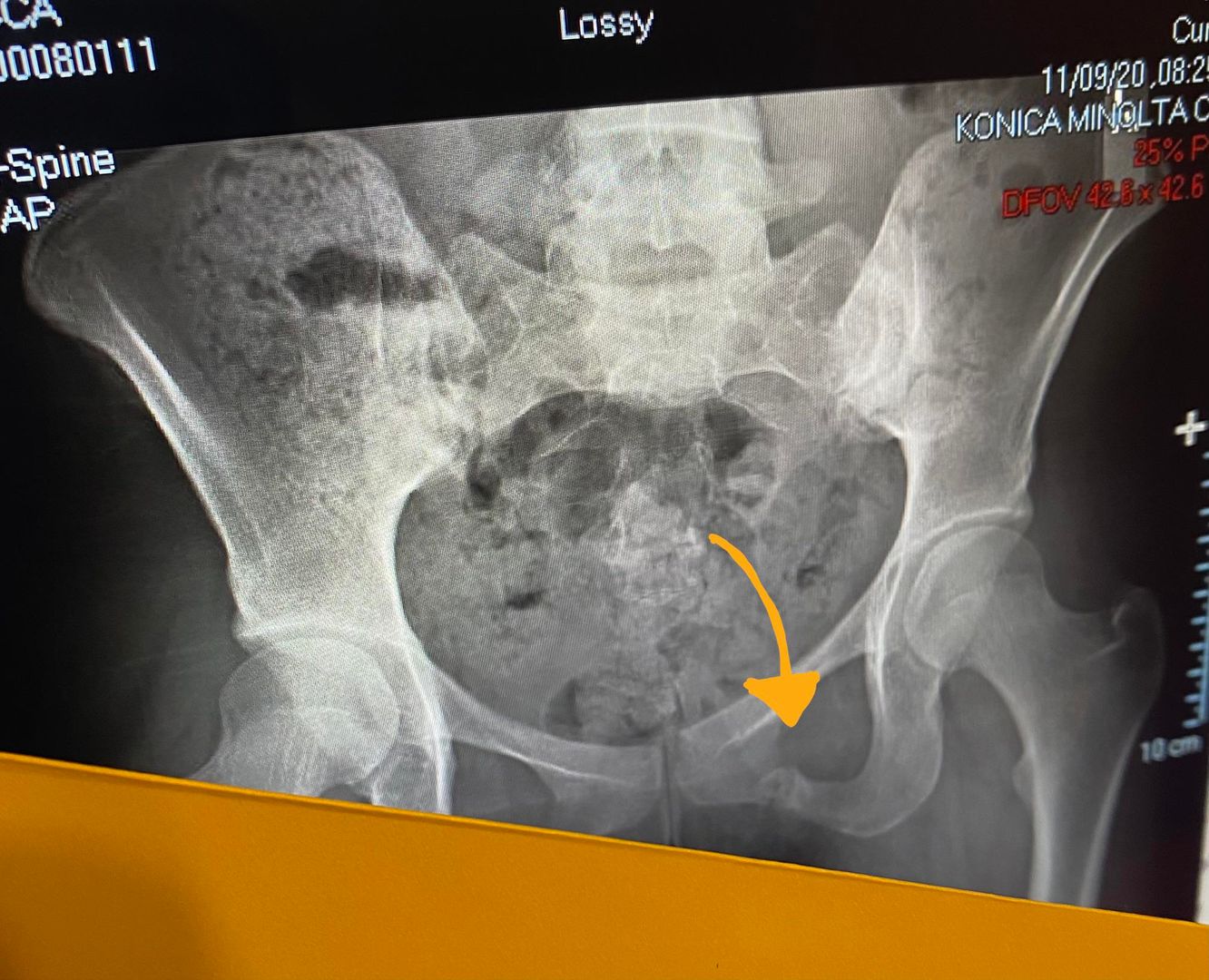 One year out from a pubic ramus fracture, does anyone else still have bone pain after it's ...
