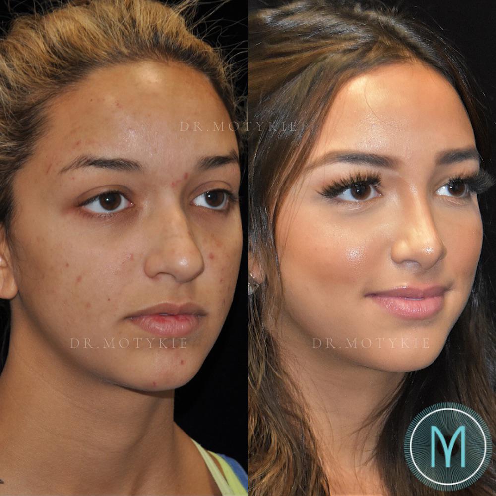 One year post-op: Primary Rhinoplasty | Scrolller