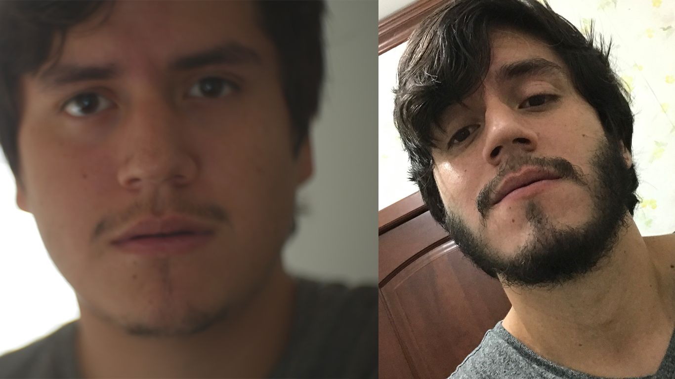 Pre minox vs 8 Months in | Scrolller