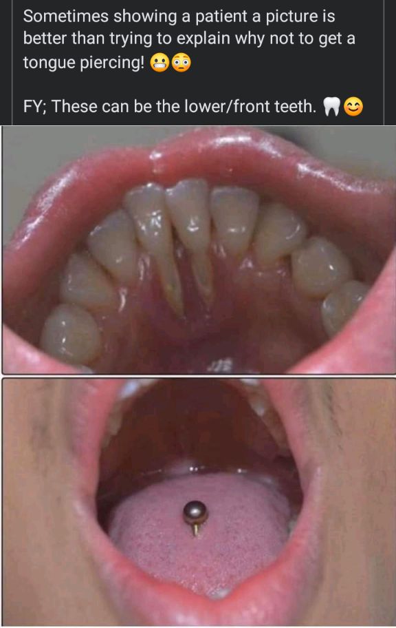 Discover more like Eyeblech: Scraped gums from tongue piercing and Related Content | Scrolller