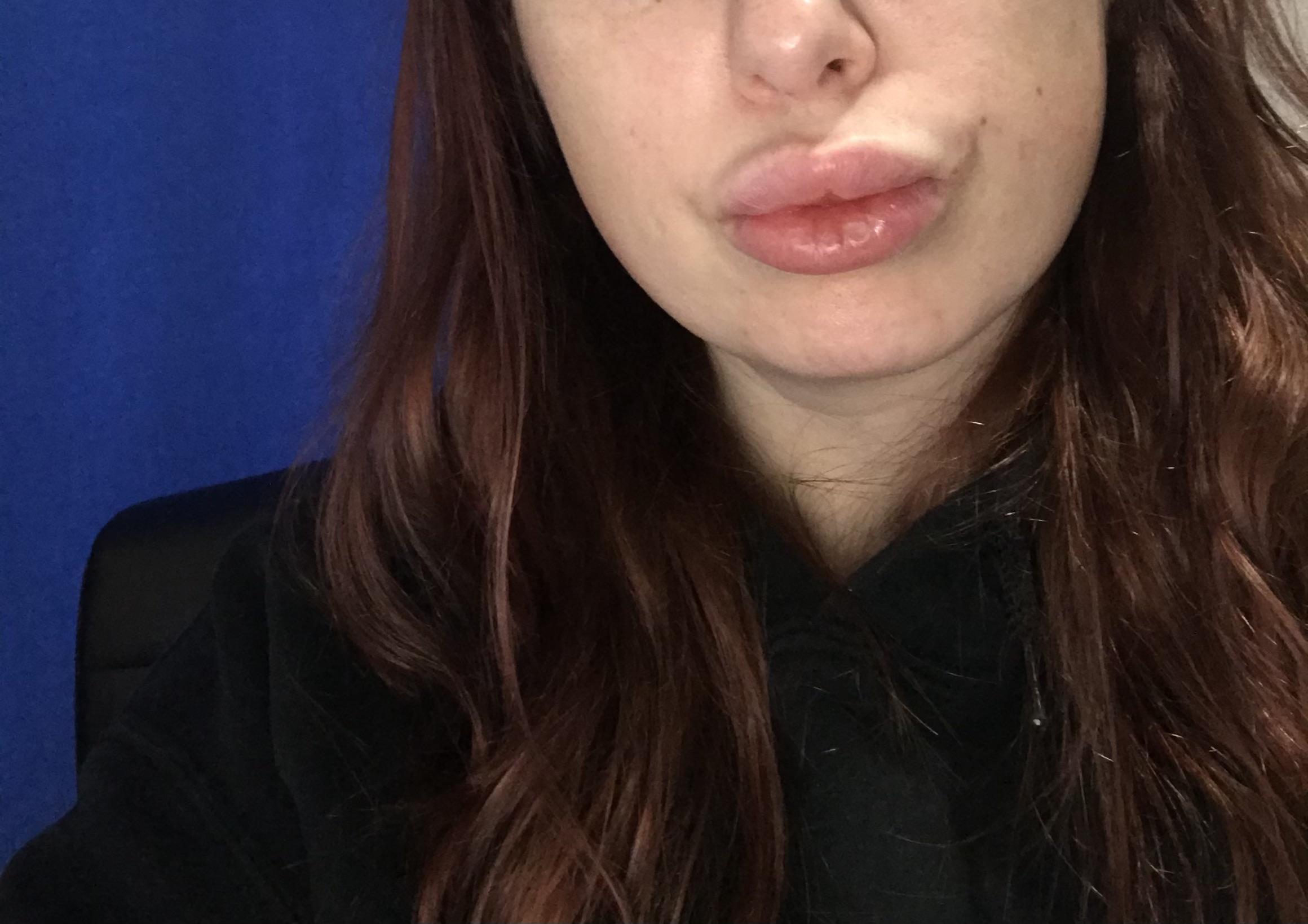 She due for another injection soon | Scrolller