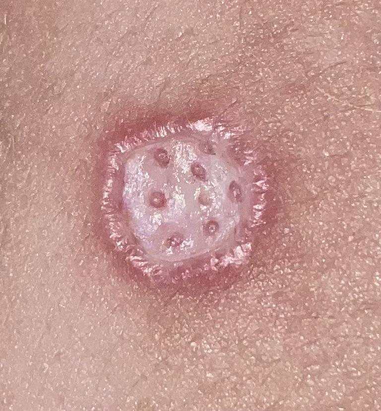 Skin after a mole removal | Scrolller