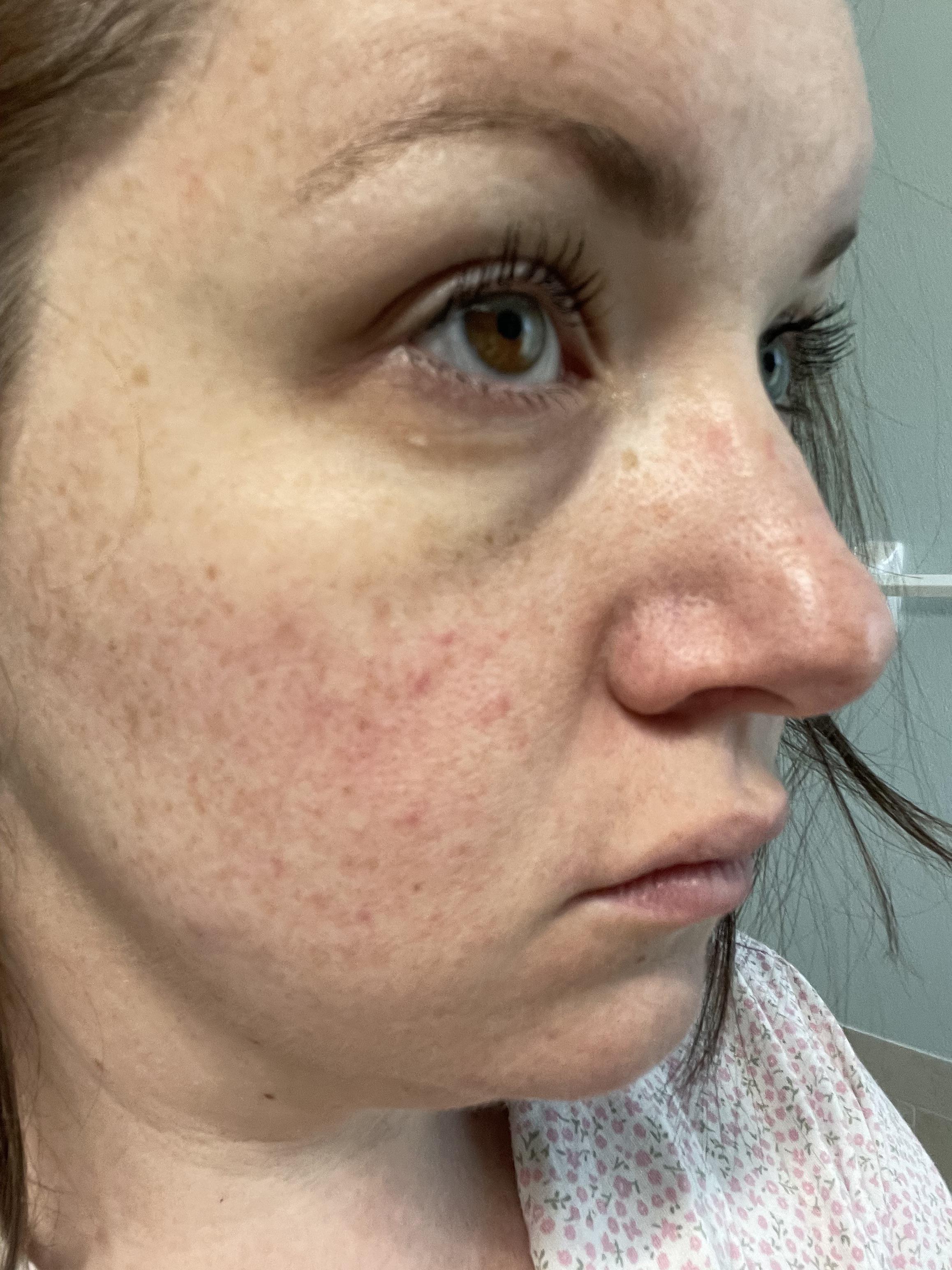 [Skin Concerns] Uneven skin tone and red bumps (routine in comments) | Scrolller