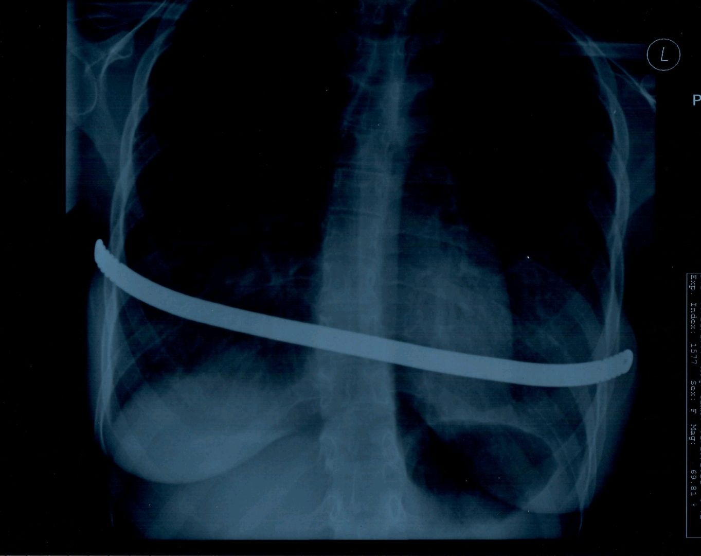 This is my xray..i can see the bar sticking out and here it looks like its not connected to my ...