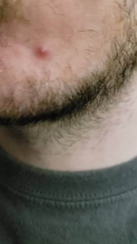 This pimple was growing all day. Finally gave it the ol' heave-ho. | Scrolller