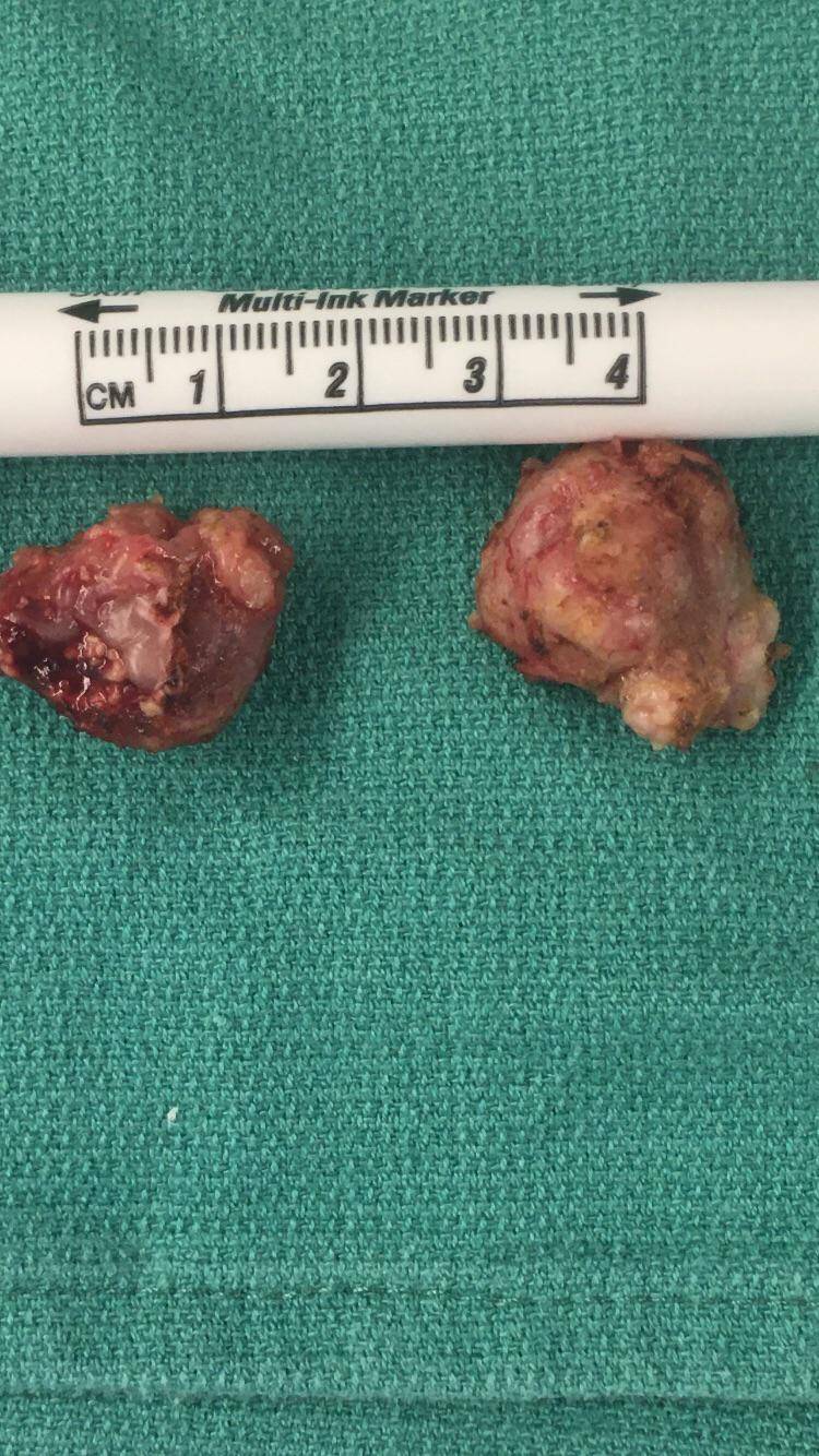 Tonsillectomy pics from my surgeon! | Scrolller