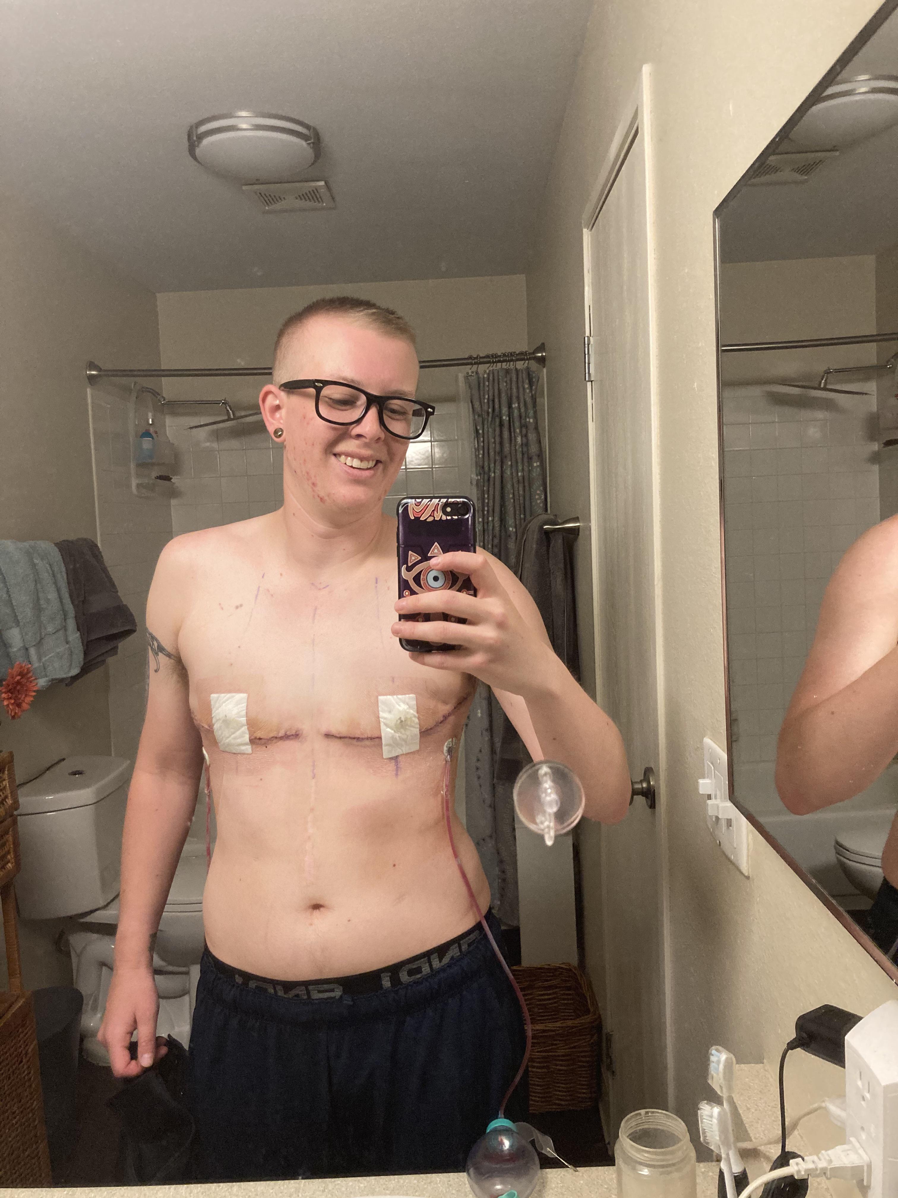 Two days post op! | Scrolller