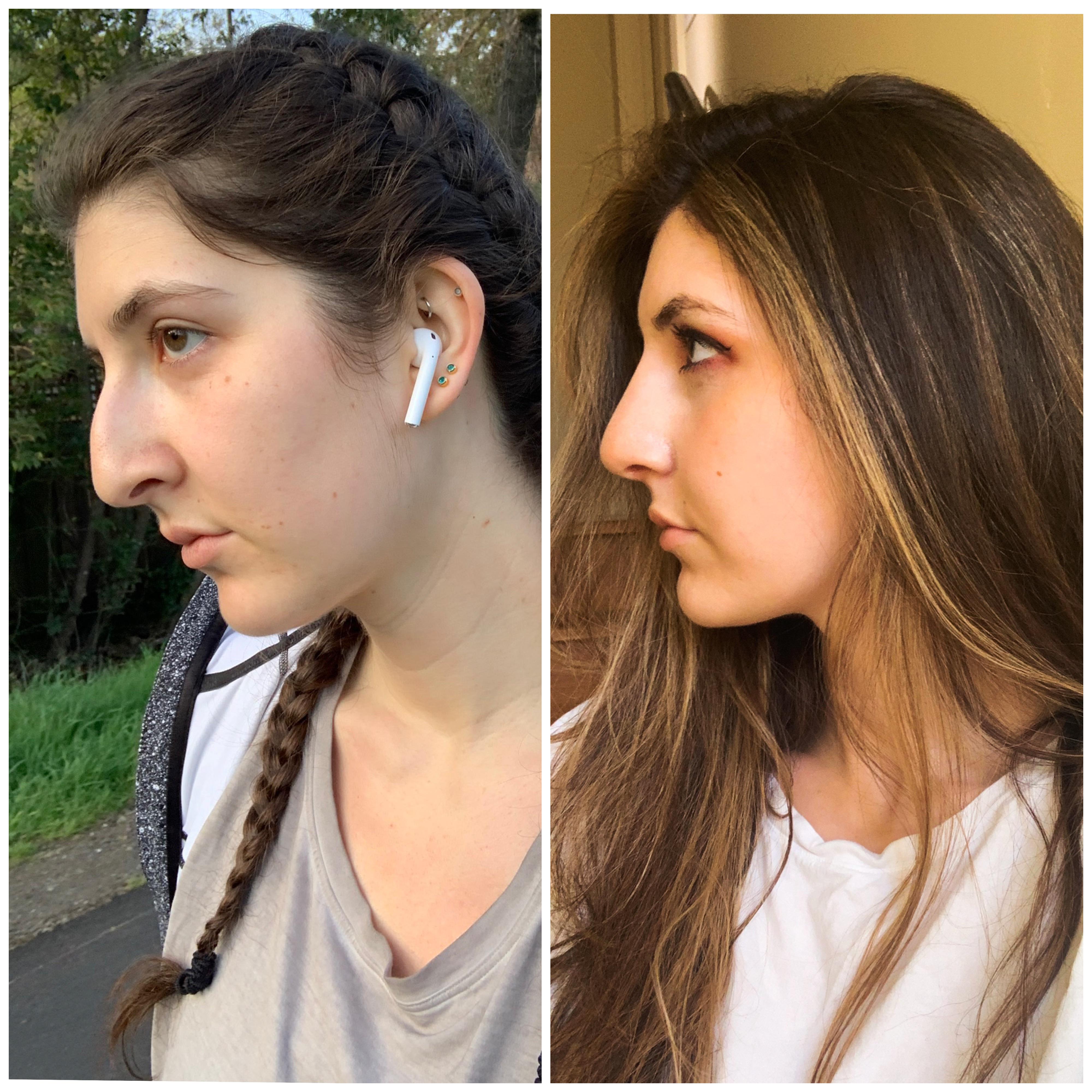 Two weeks post op from rhinoplasty. The best decision I have ever made. I am absolutely in love ...