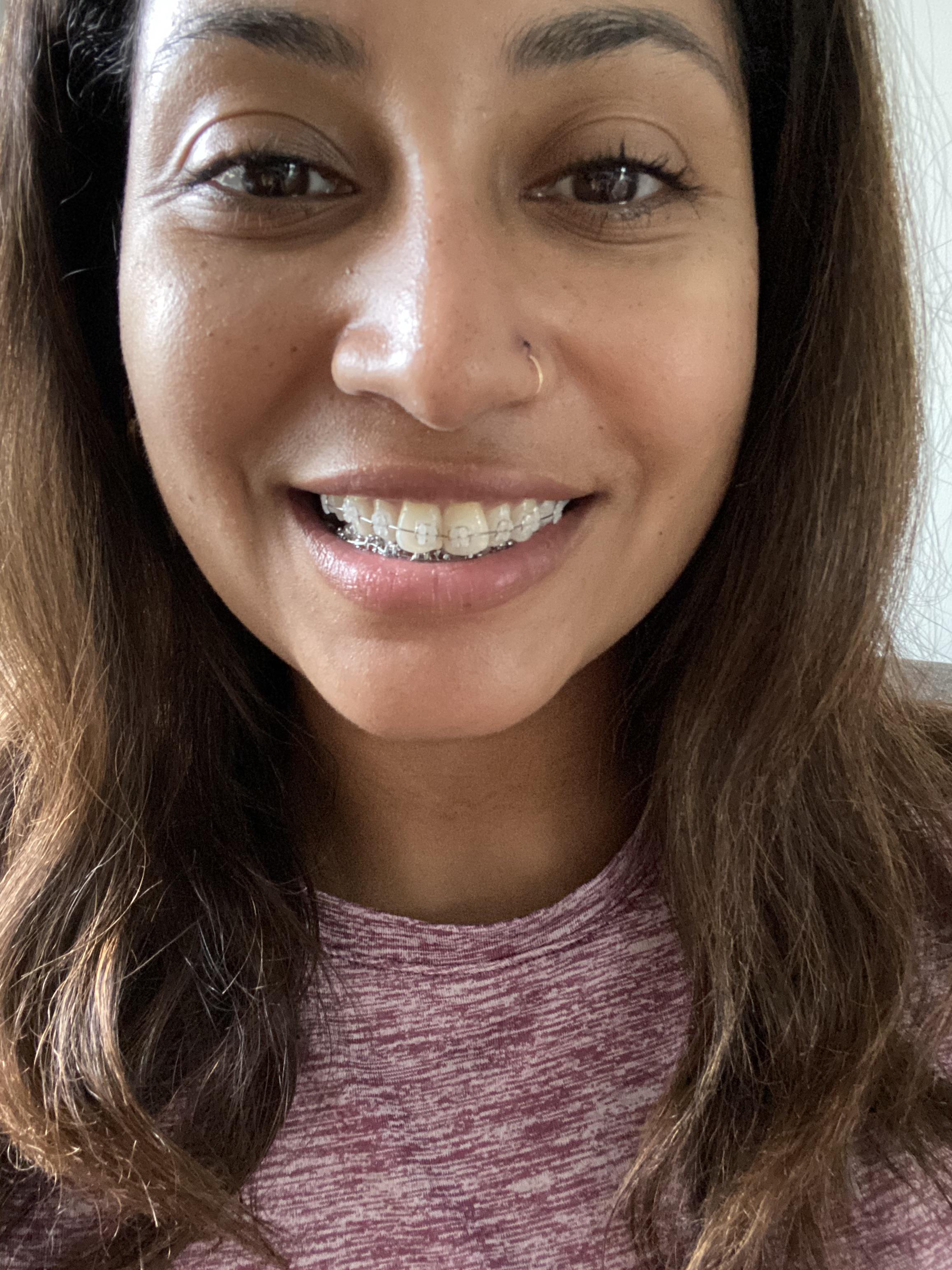 Where are my first day buddies? Finally got braces at 33! | Scrolller