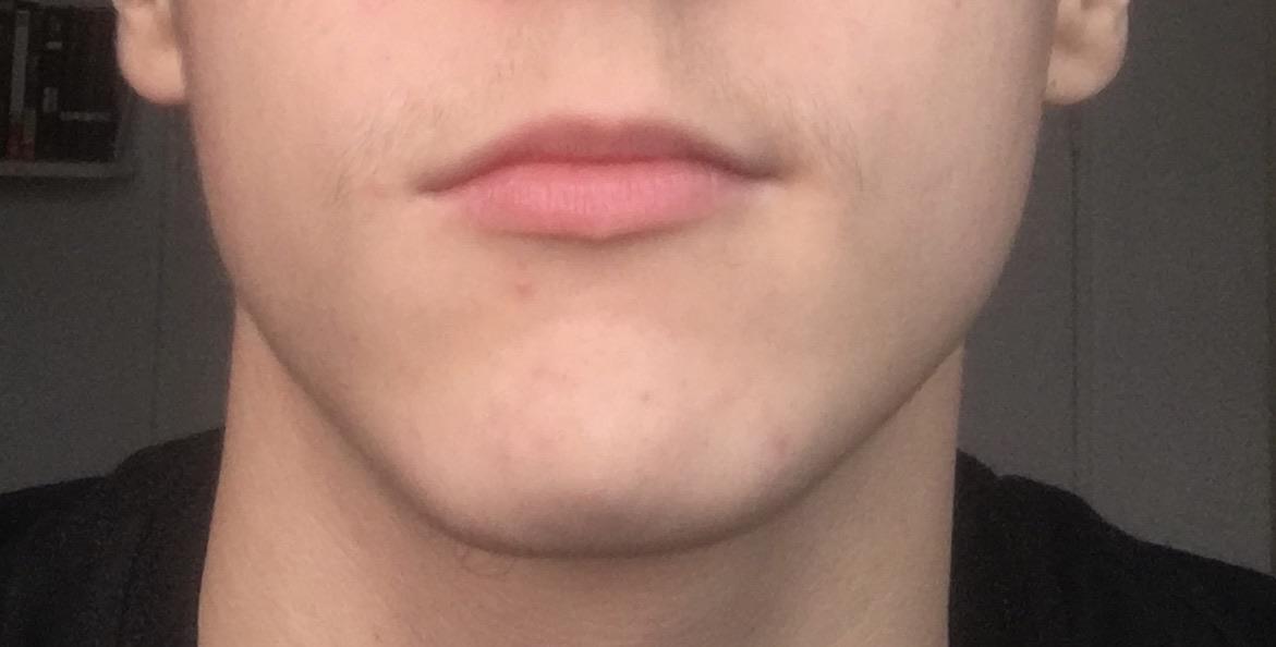 Will mewing fix this asymmetrical jawline? | Scrolller