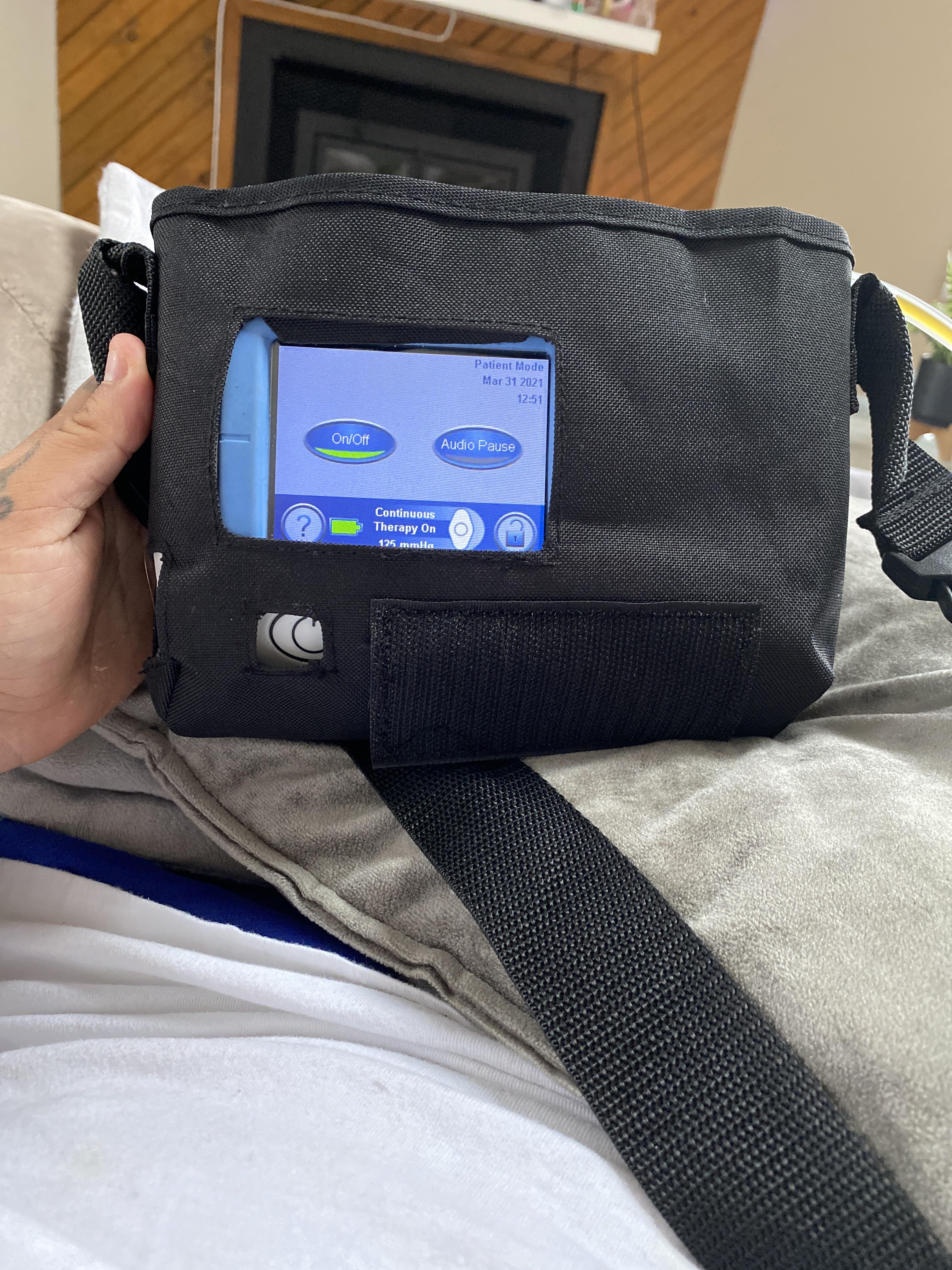 Wound Vac Stage 1 Phalloplasty | Scrolller