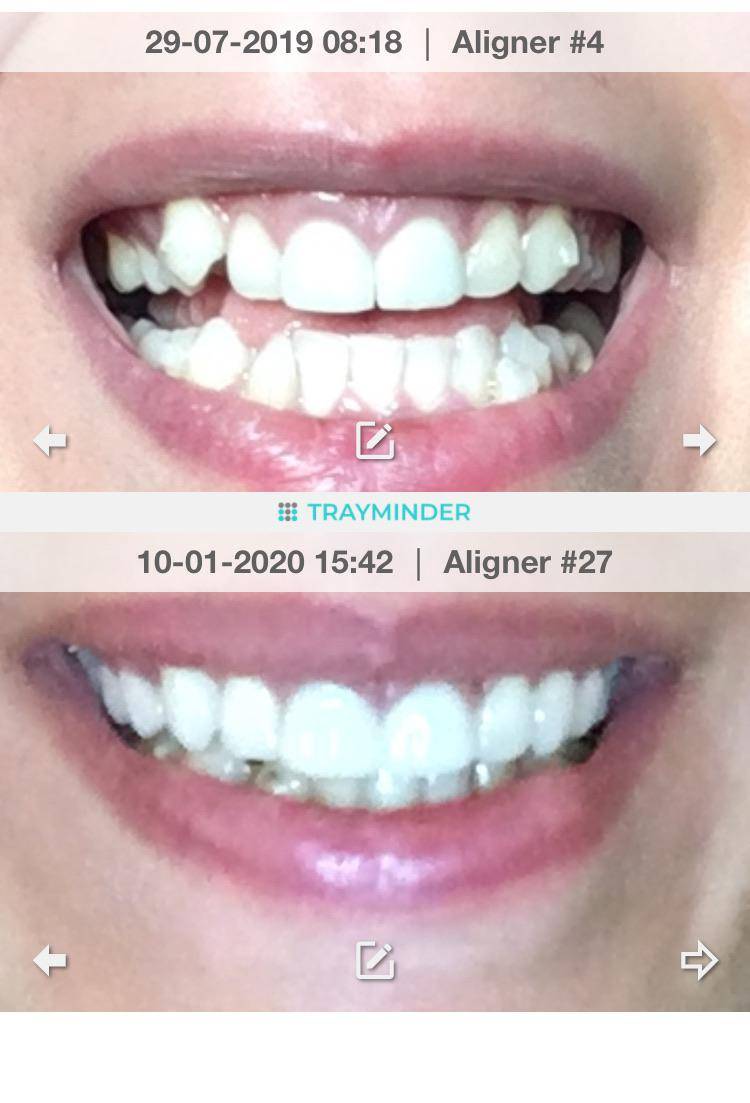 Yeii 💗 upper teeth progress | Scrolller