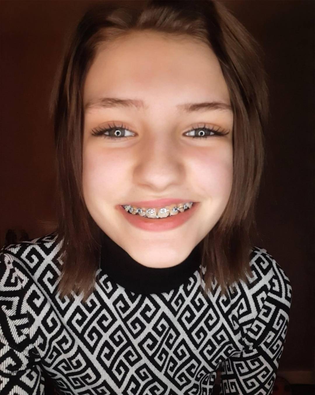 A Close Up Of My Face And My Braces Now You Have To Spunk All Over It
