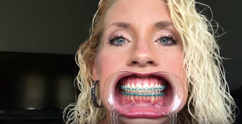 Braces Scrolller