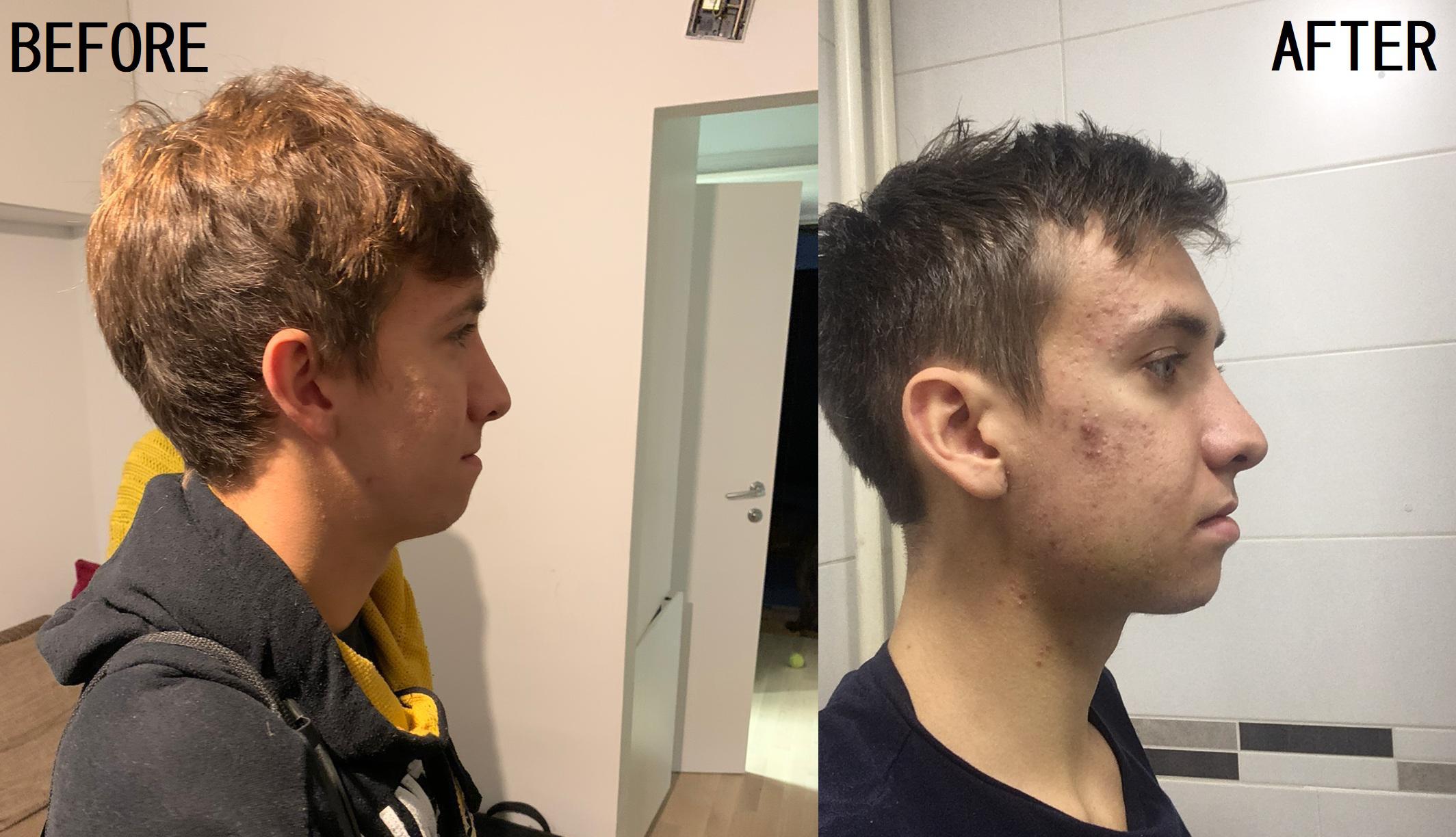 1 month post-op DJS! | Scrolller