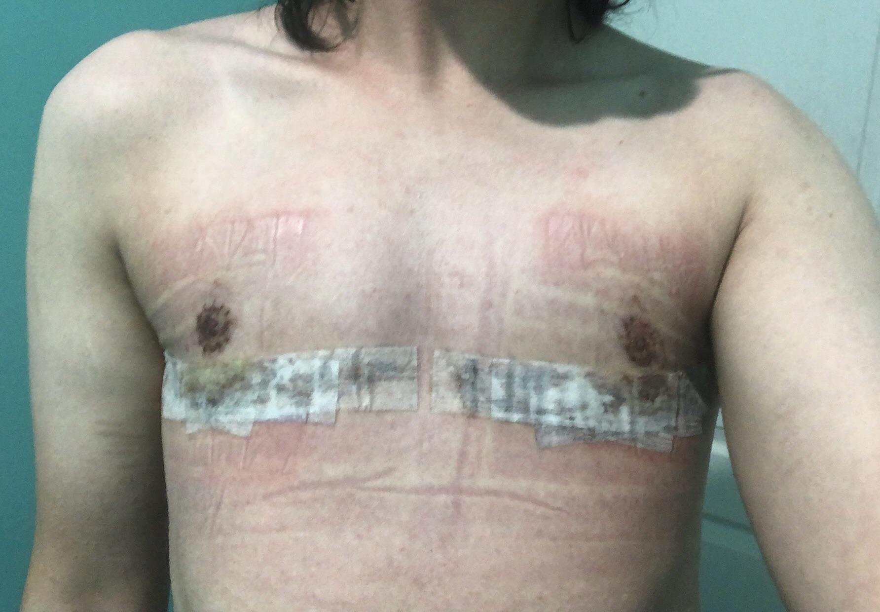 11 days post op w/ Dr Garramone | Scrolller