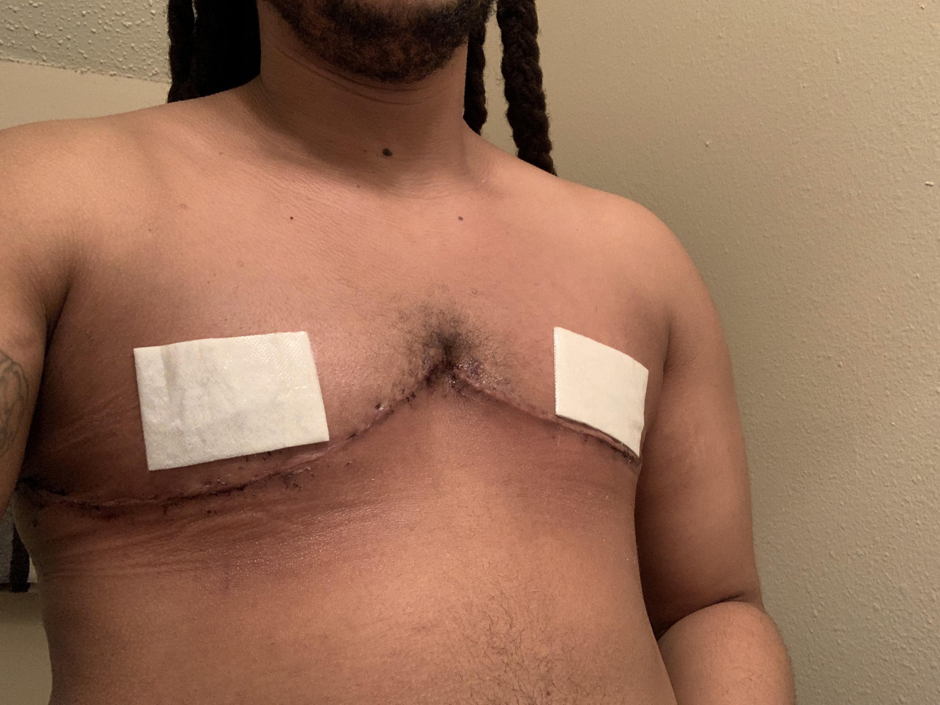 2 weeks post op | Scrolller