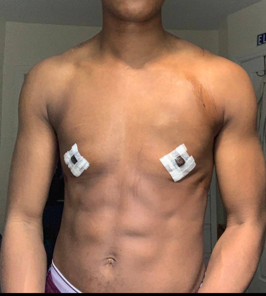20 days post-op | Scrolller