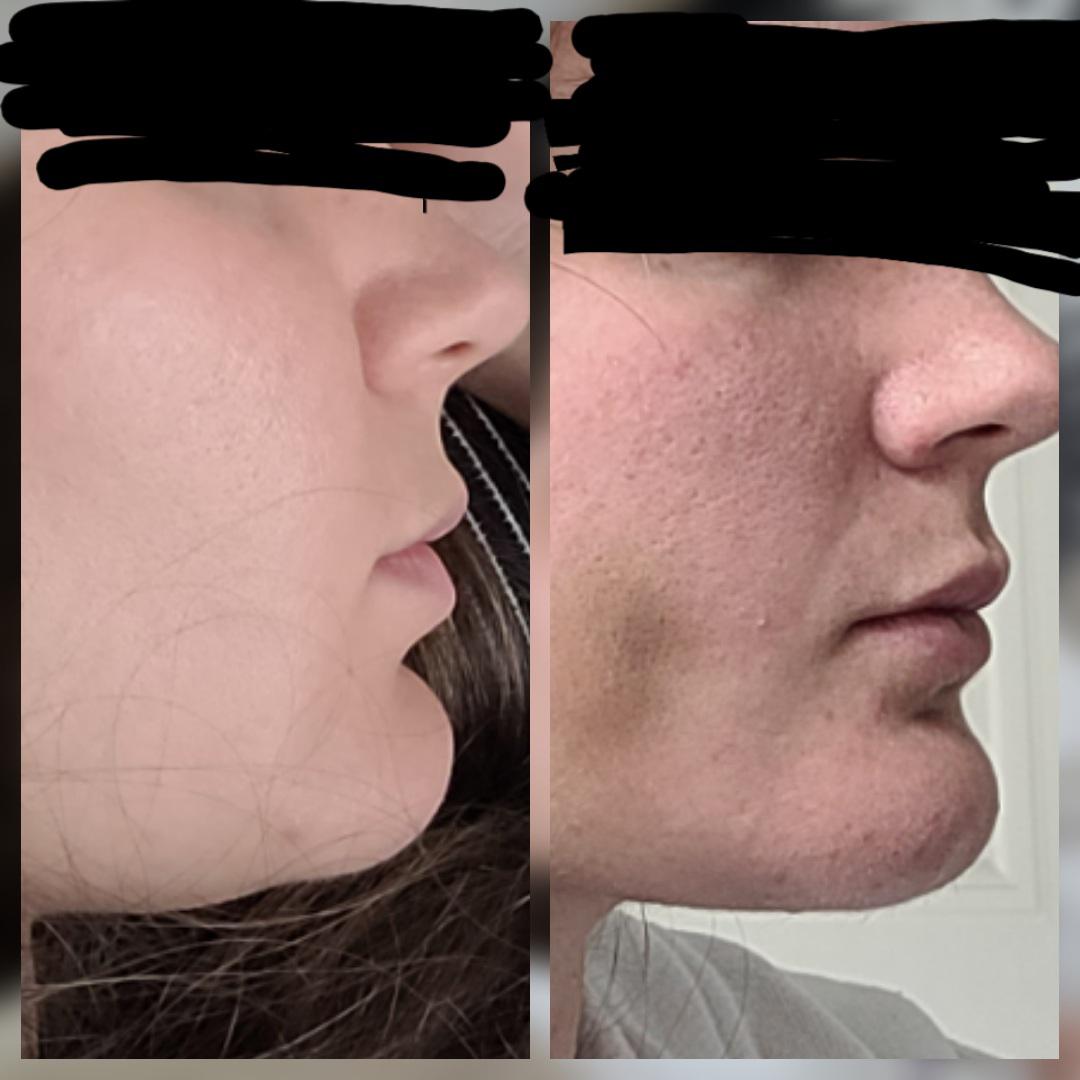 3 weeks post jaw/chin implant. Swelling? | Scrolller