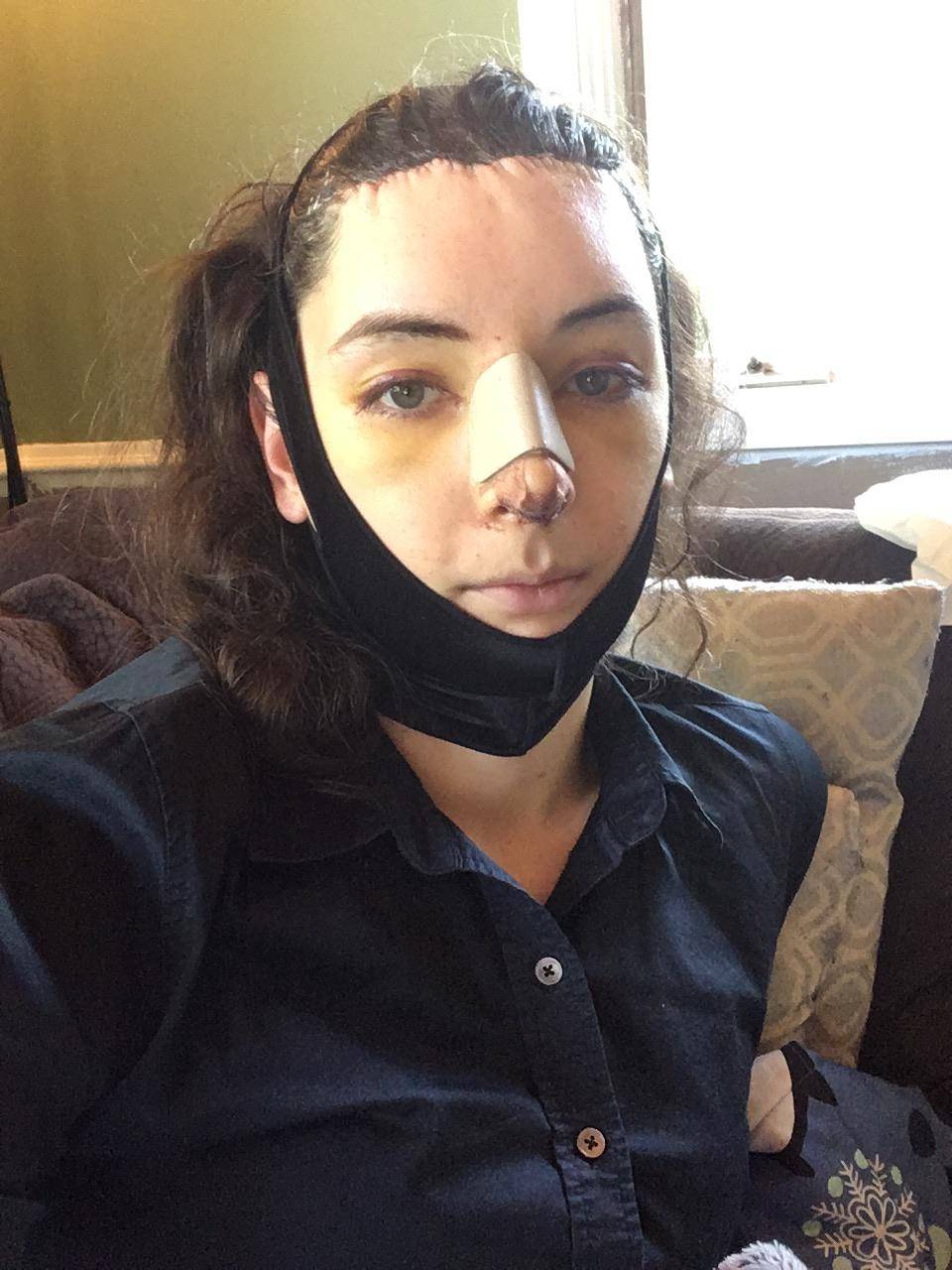 4 days post-op FFS, Dr Rolfes | Scrolller