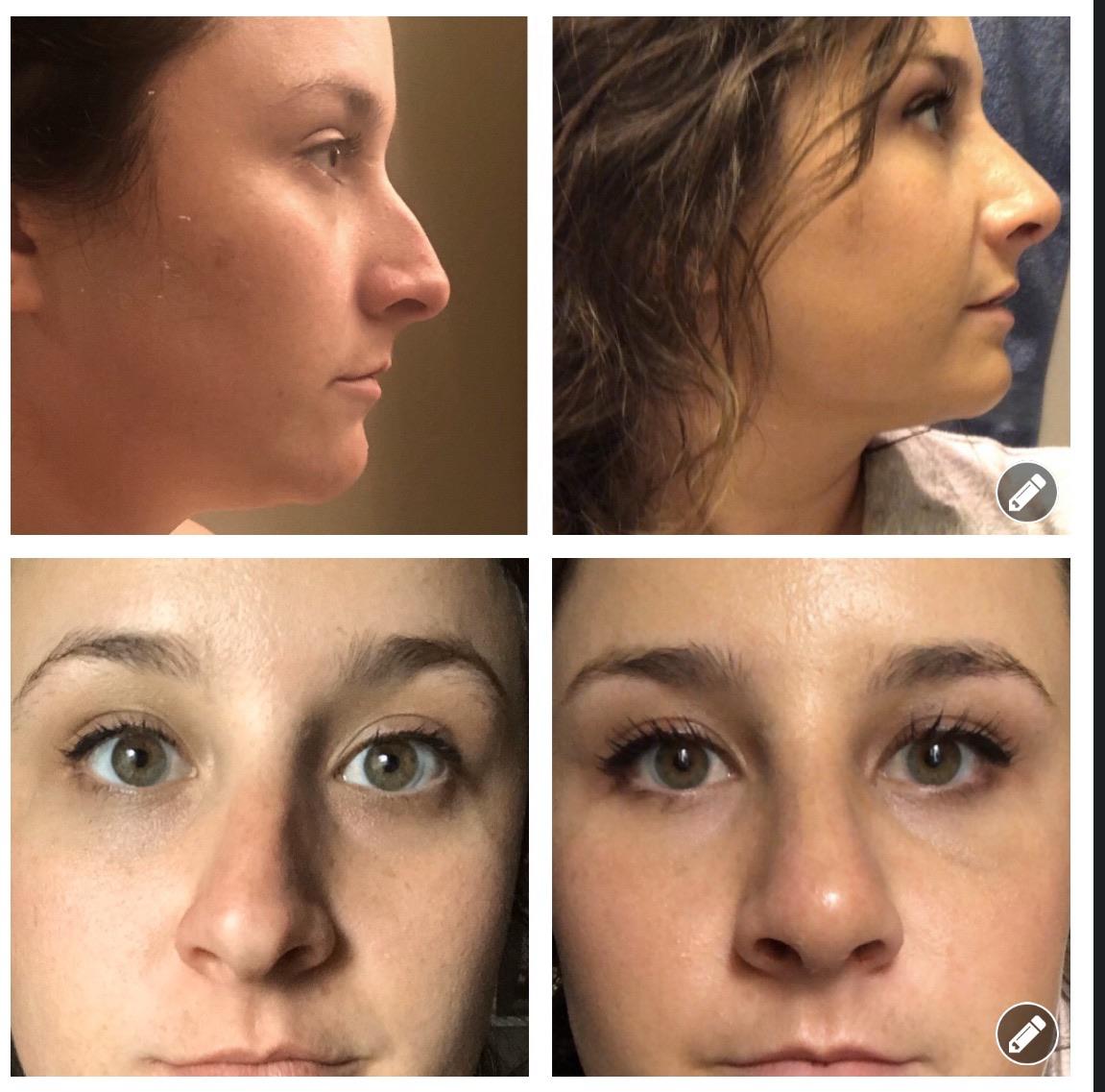 6 days post septorhinoplasty with turbinate reduction! | Scrolller