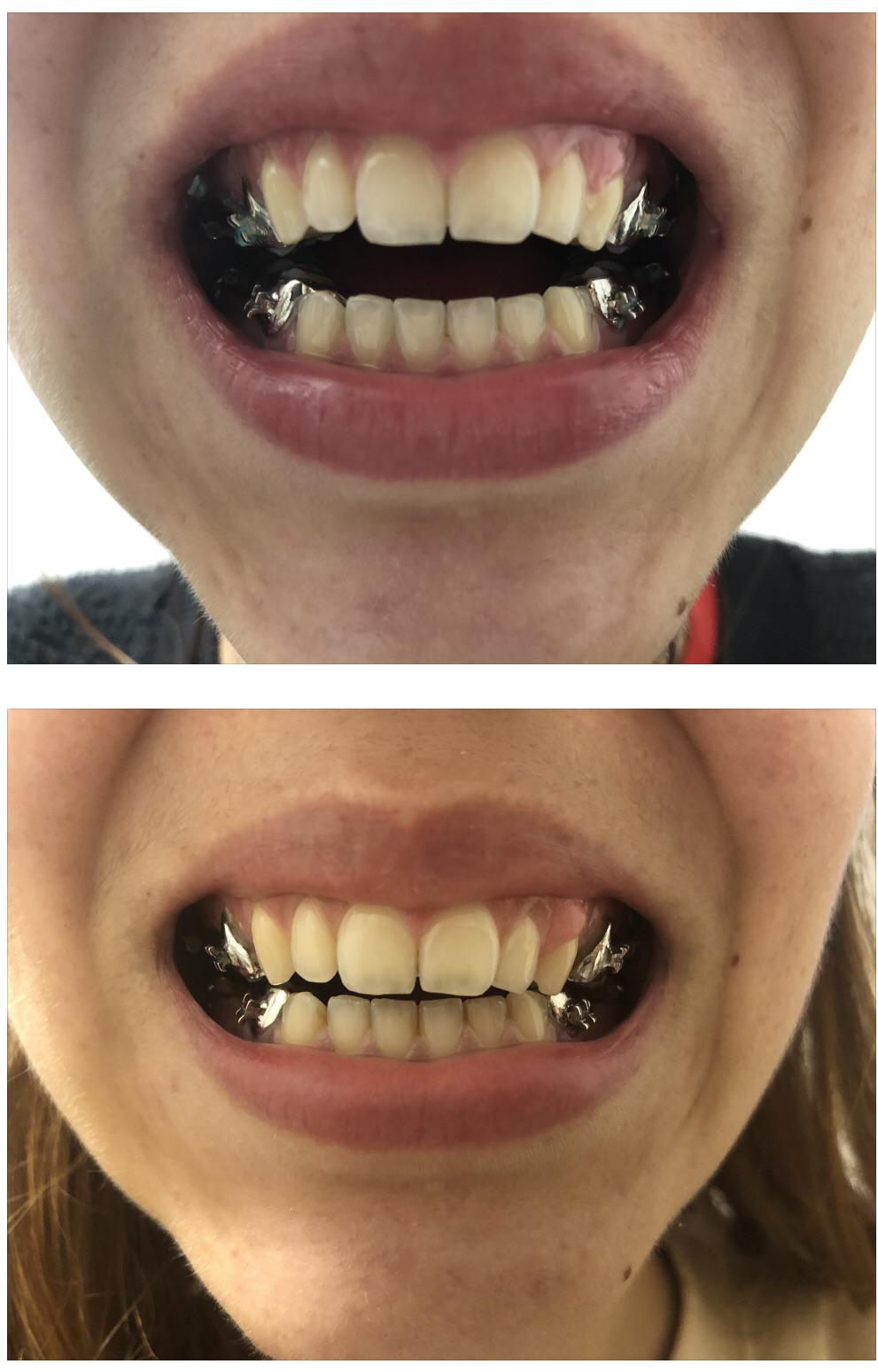 6 months Progress - Anterior Open Bite | Scrolller