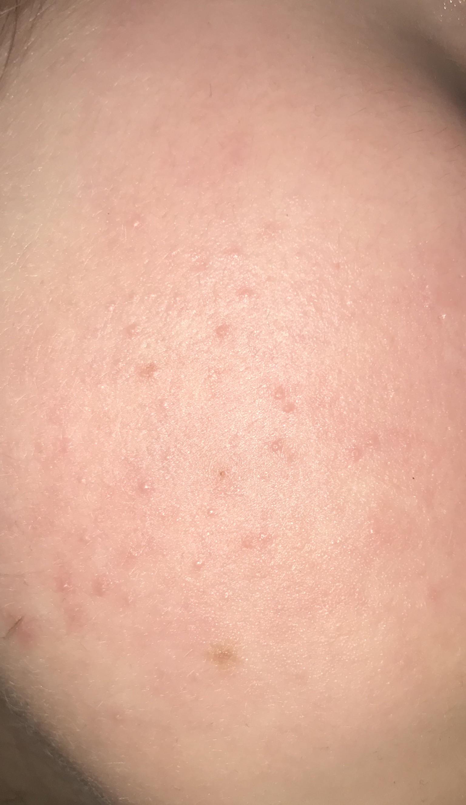 Any tips for getting rid of keratosis on face? I have clear skin except for the little bumps ...