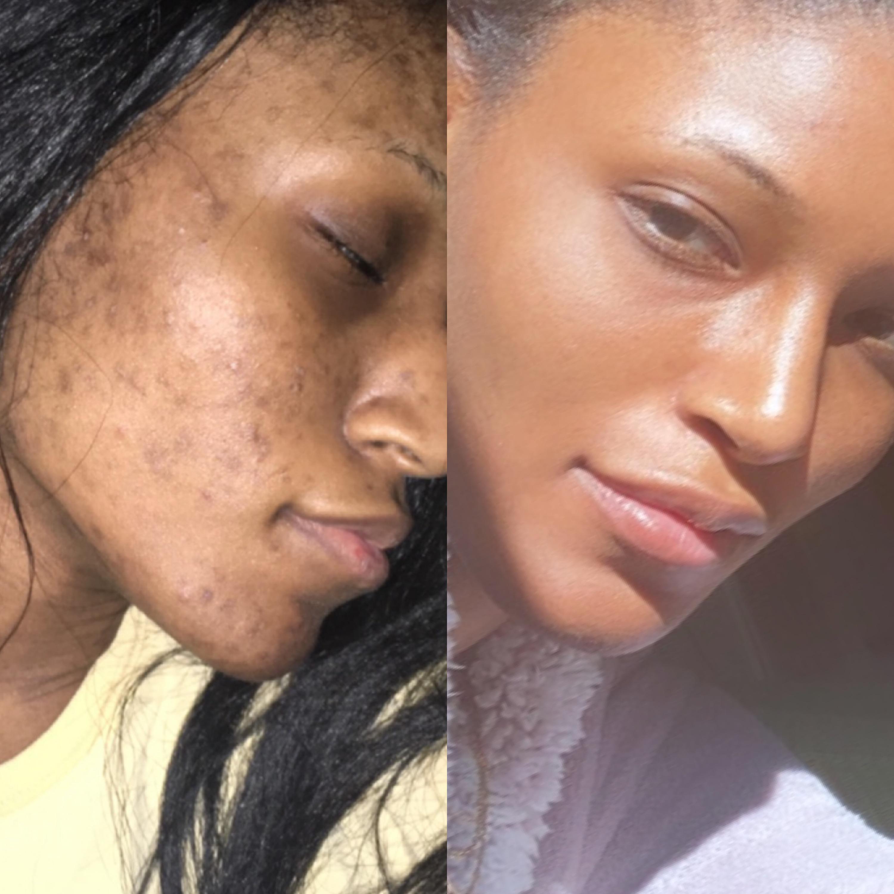 [B&A] Hyperpigmentation improvement from 2018-2020 | Scrolller