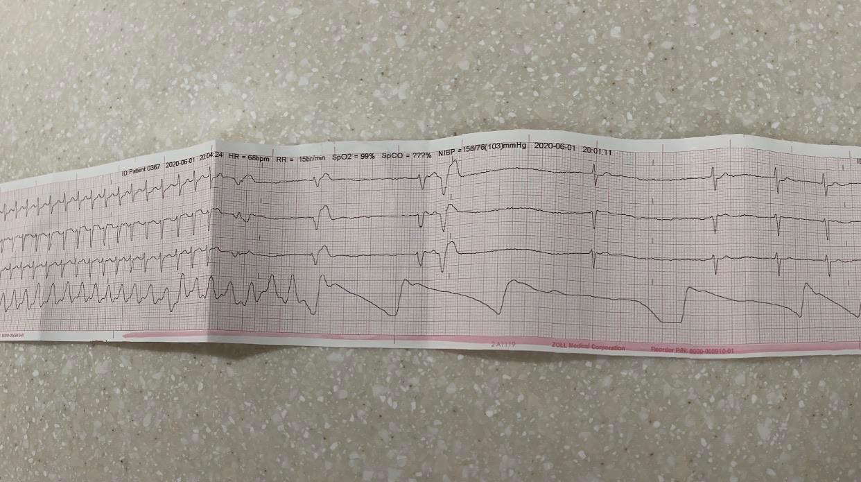 Baby’s first Adenosine conversion | Scrolller