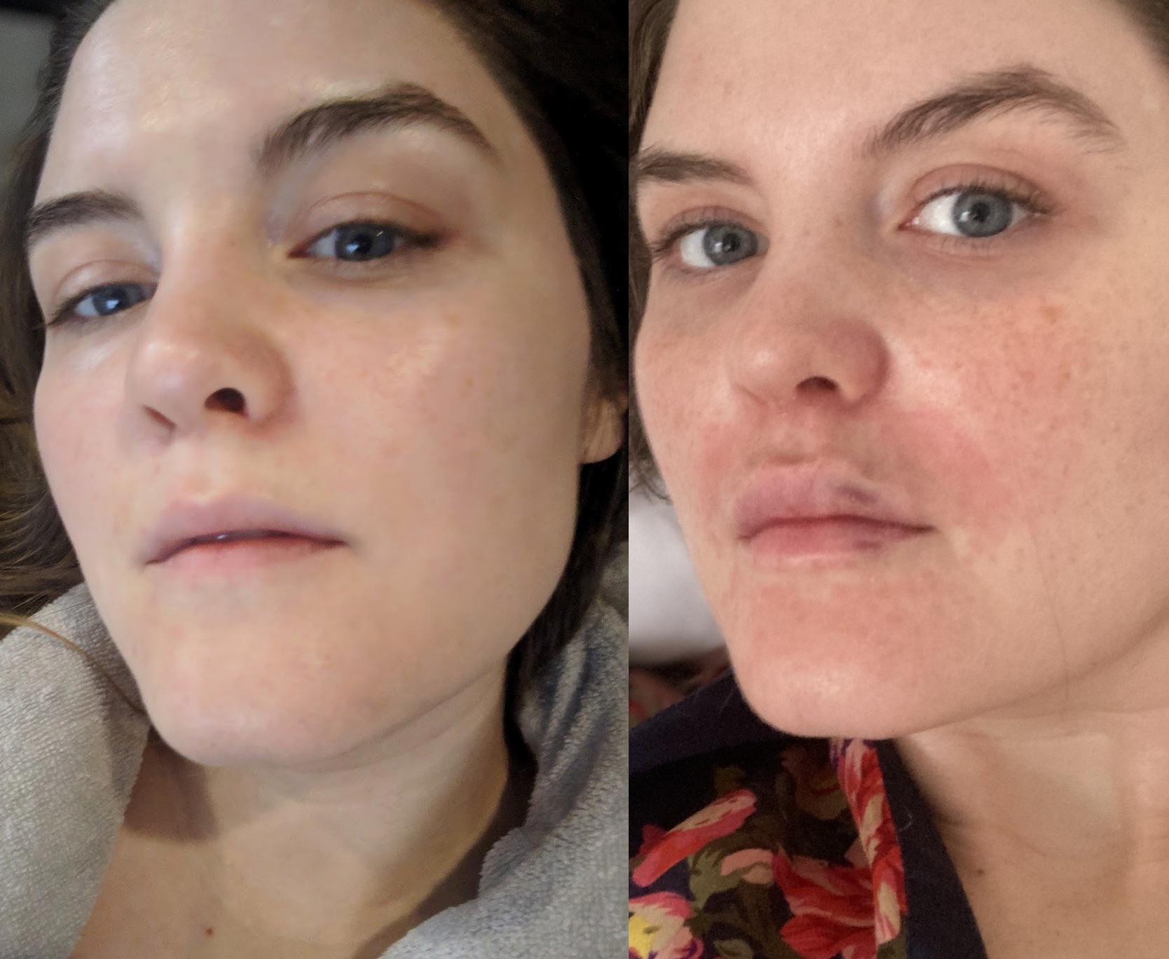 Before and after lip filler | Scrolller