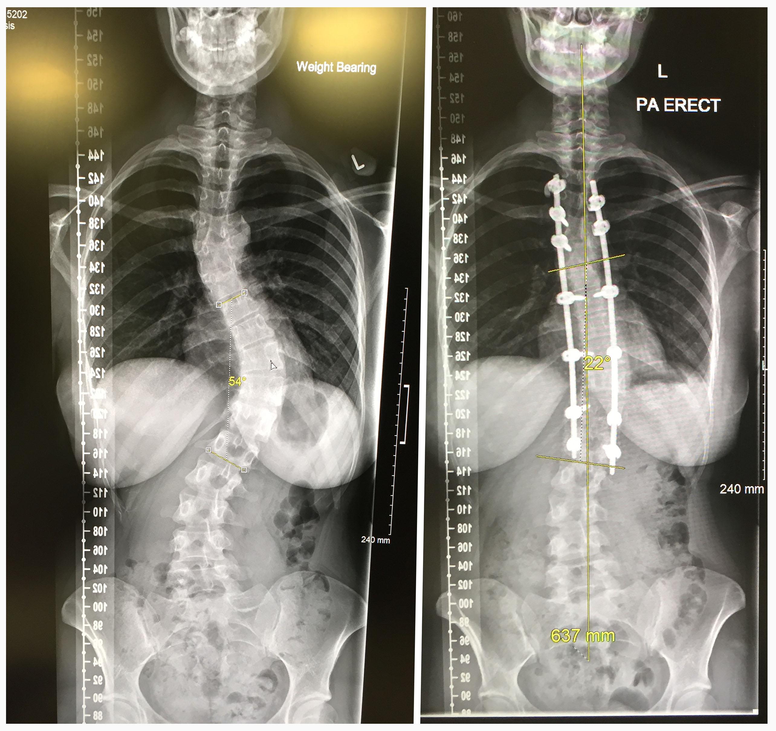 Before and after my scoliosis spinal fusion :) [OC] | Scrolller