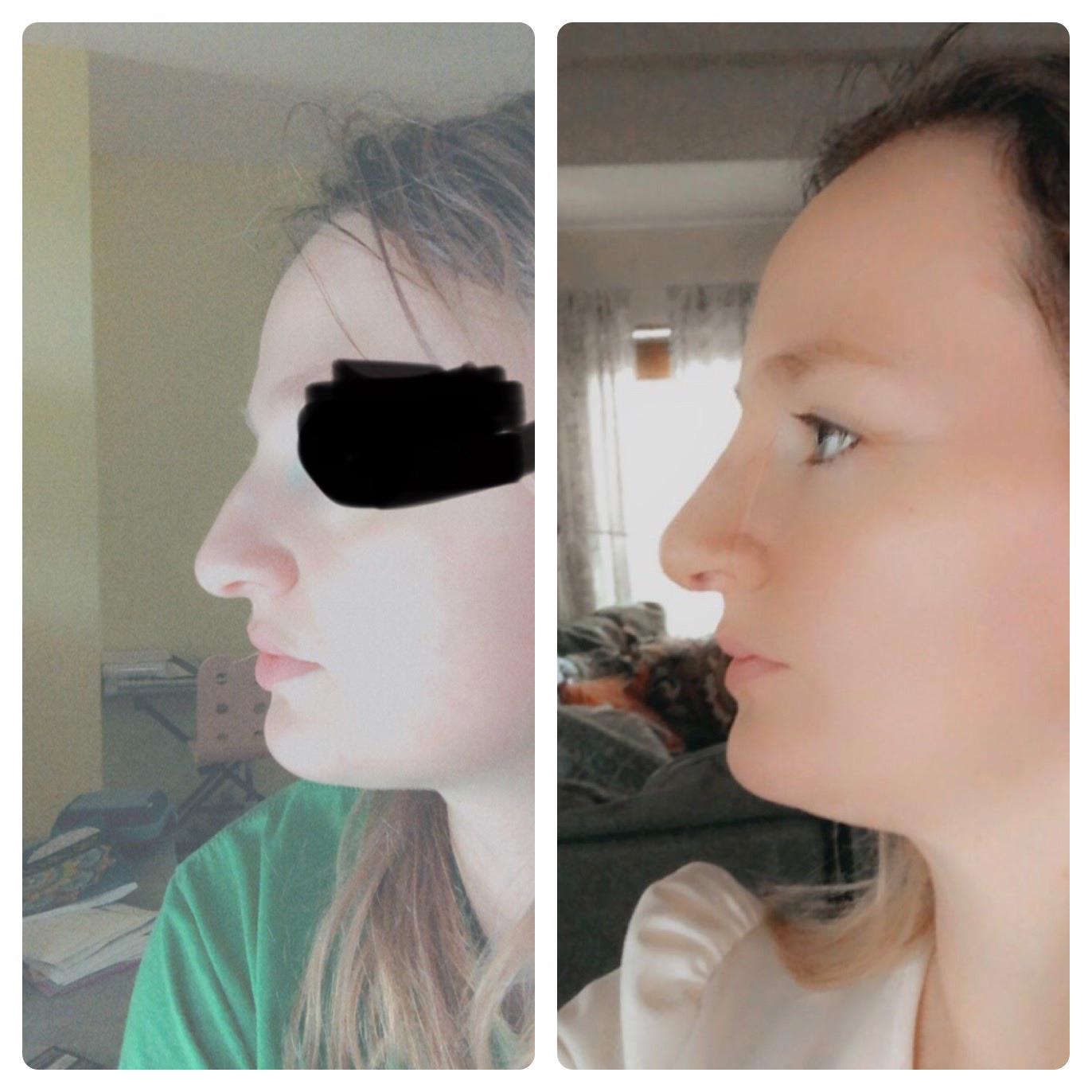 Before and JUST GOT MY CAST OFF! | Scrolller