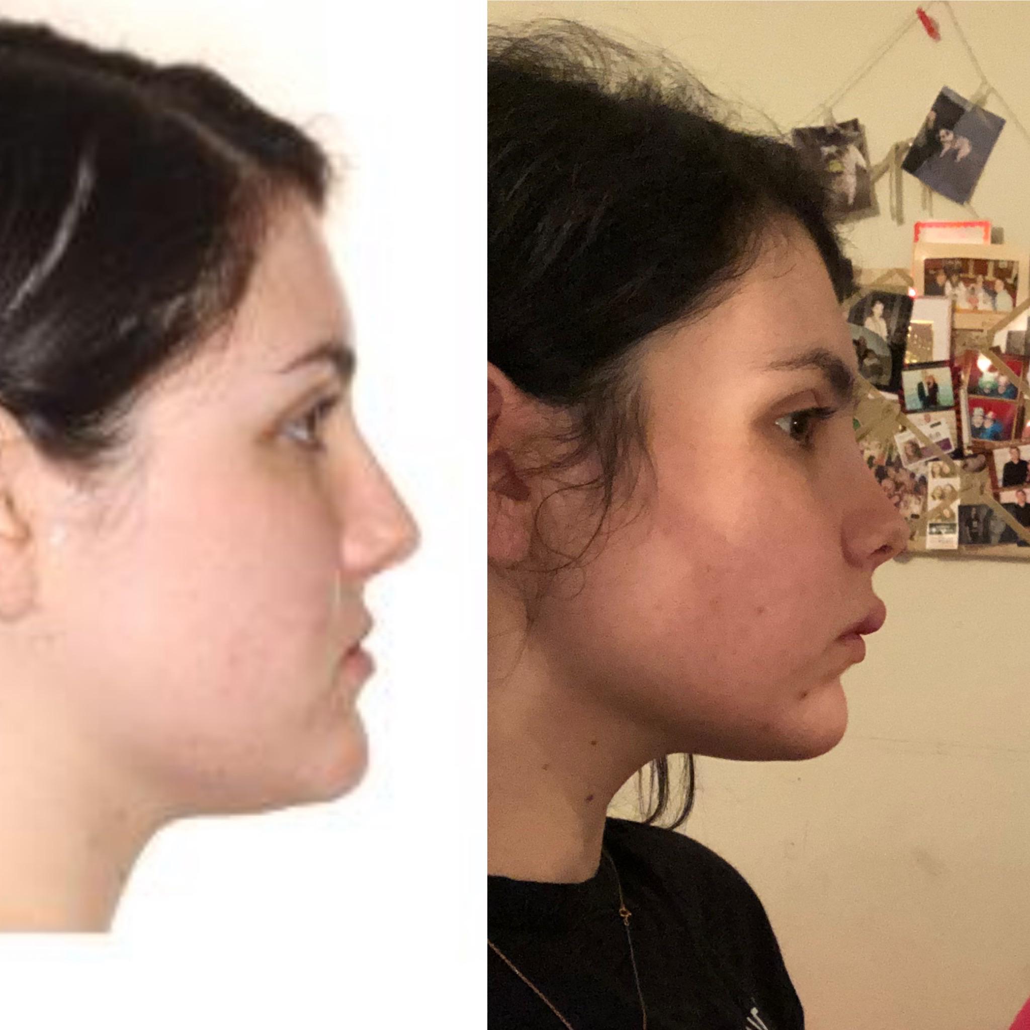 Before Upper Jaw Surgery and 9 Days After | Scrolller