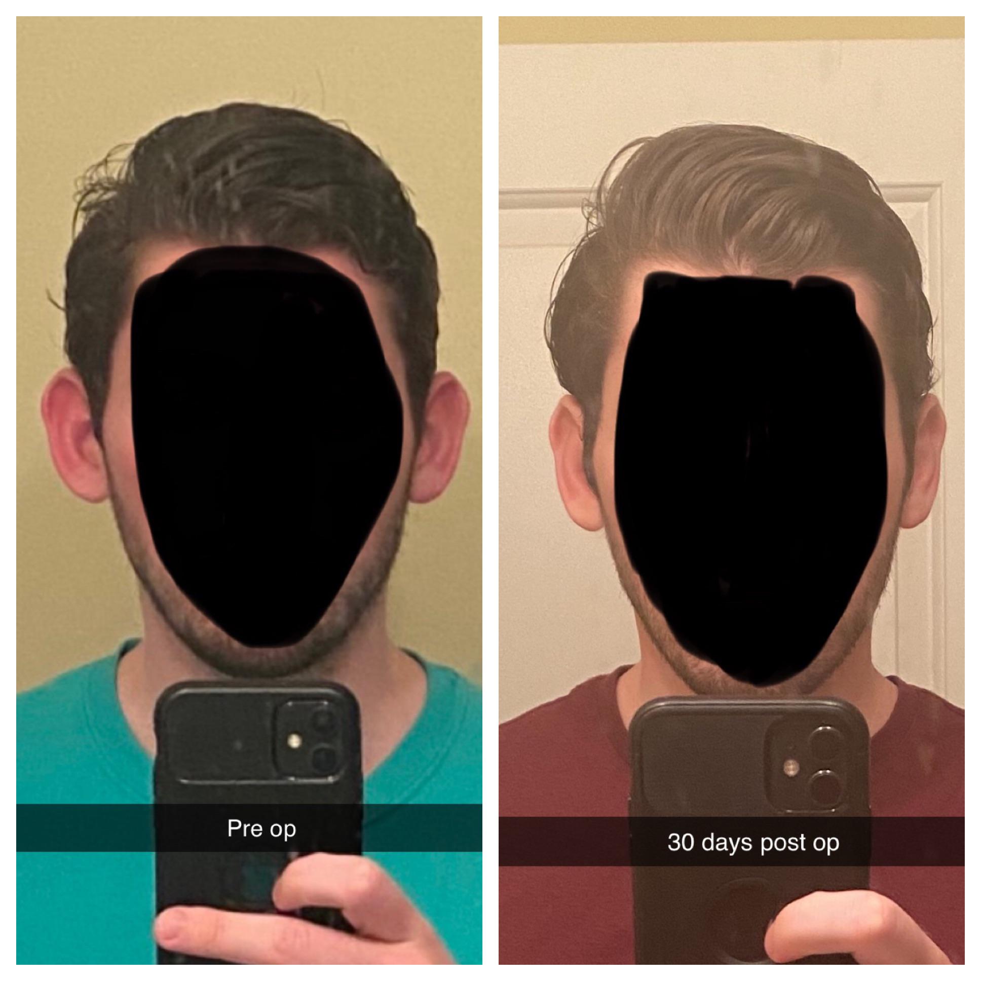 Bilateral Otoplasty Before And After Scrolller