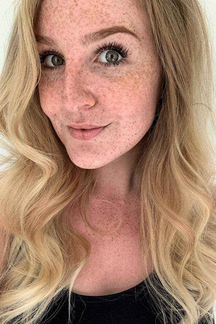 Blondes have spots too :) | Scrolller