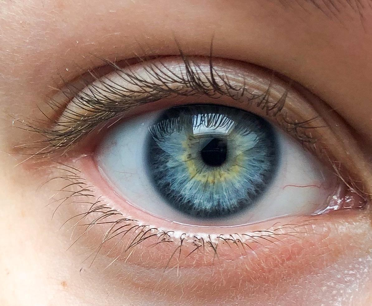 Blue central heterochromia with a yellow/hazel ring? | Scrolller
