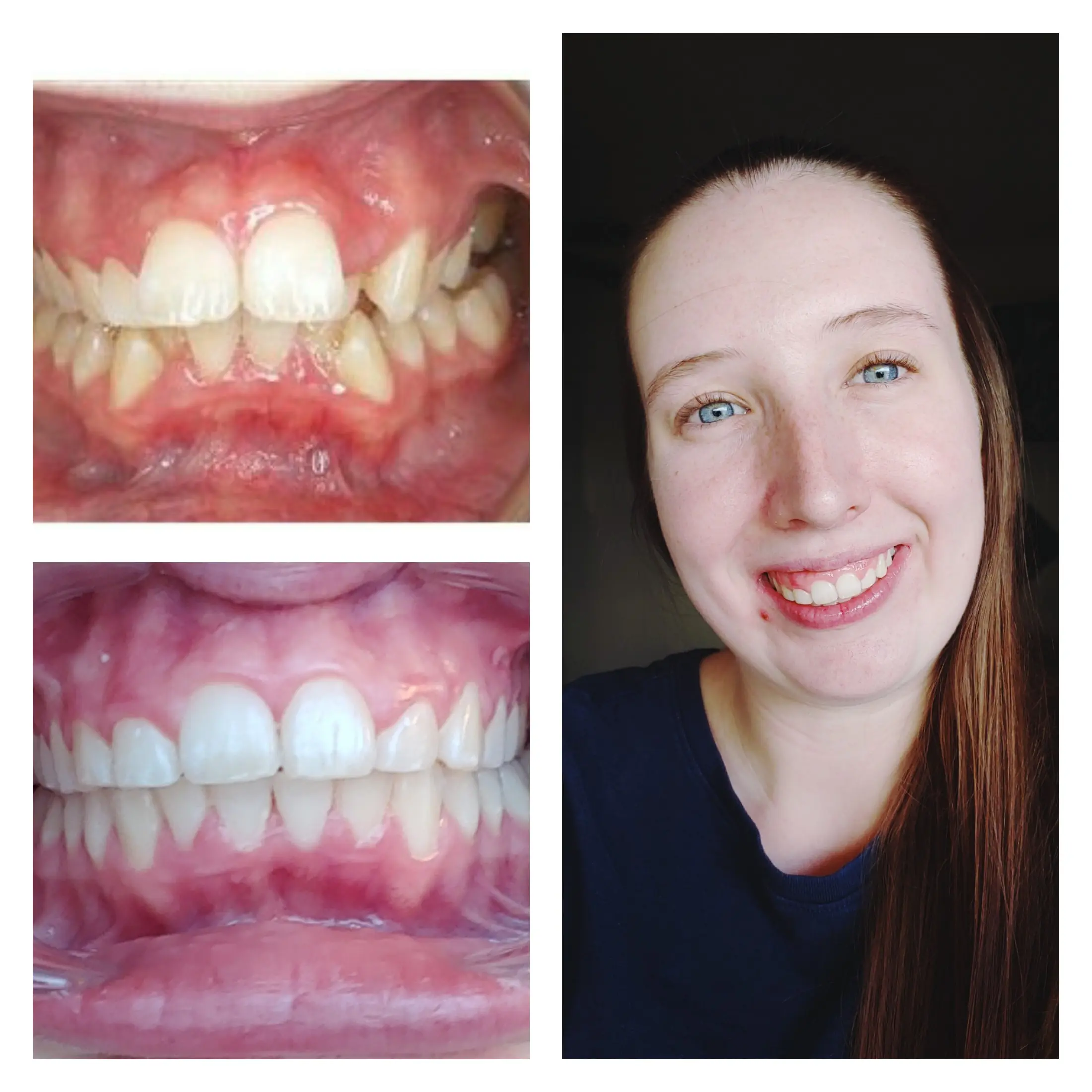 Braces Are Finally Off Scrolller
