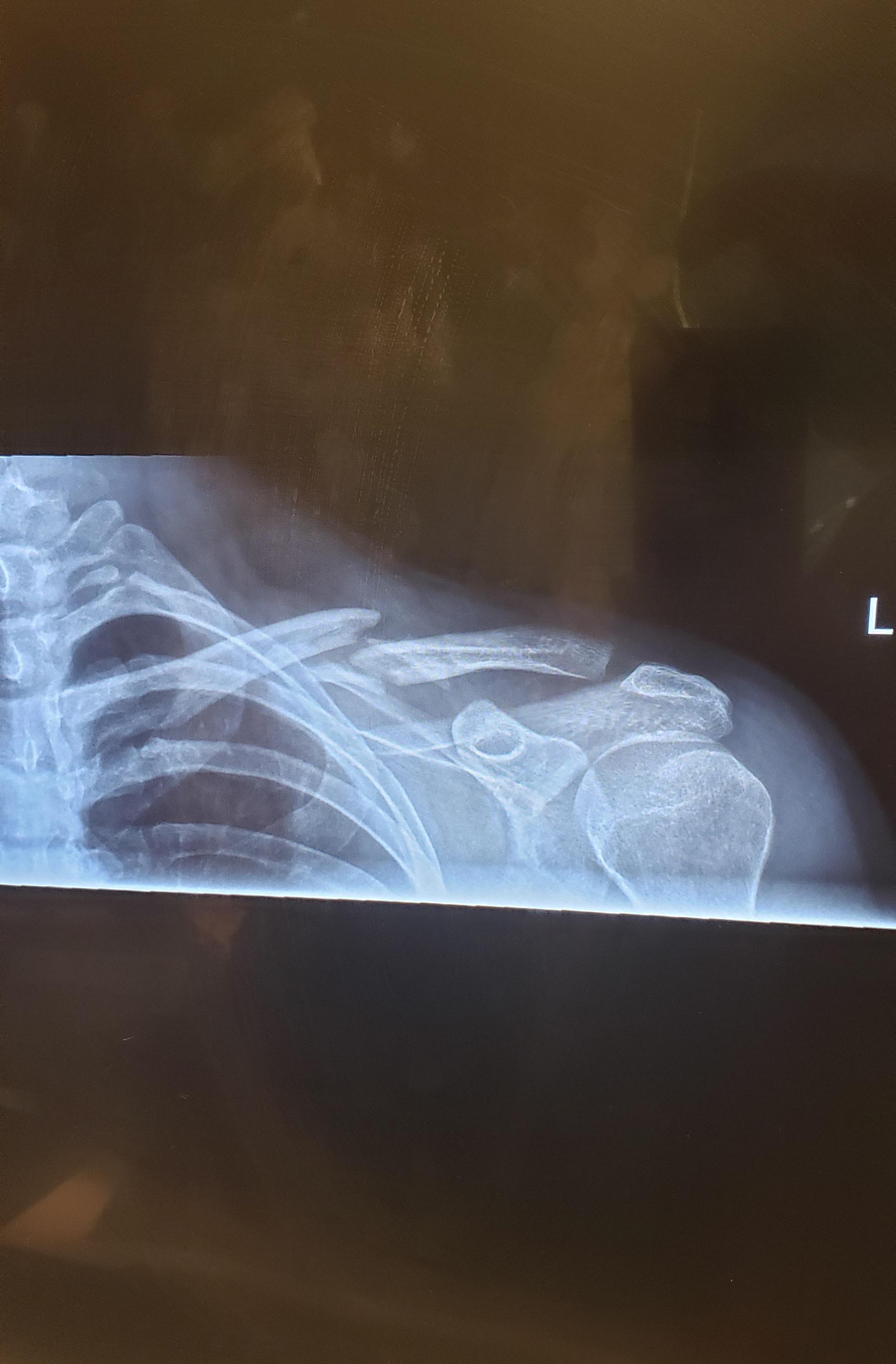 Broke my collarbone on my longboard | Scrolller