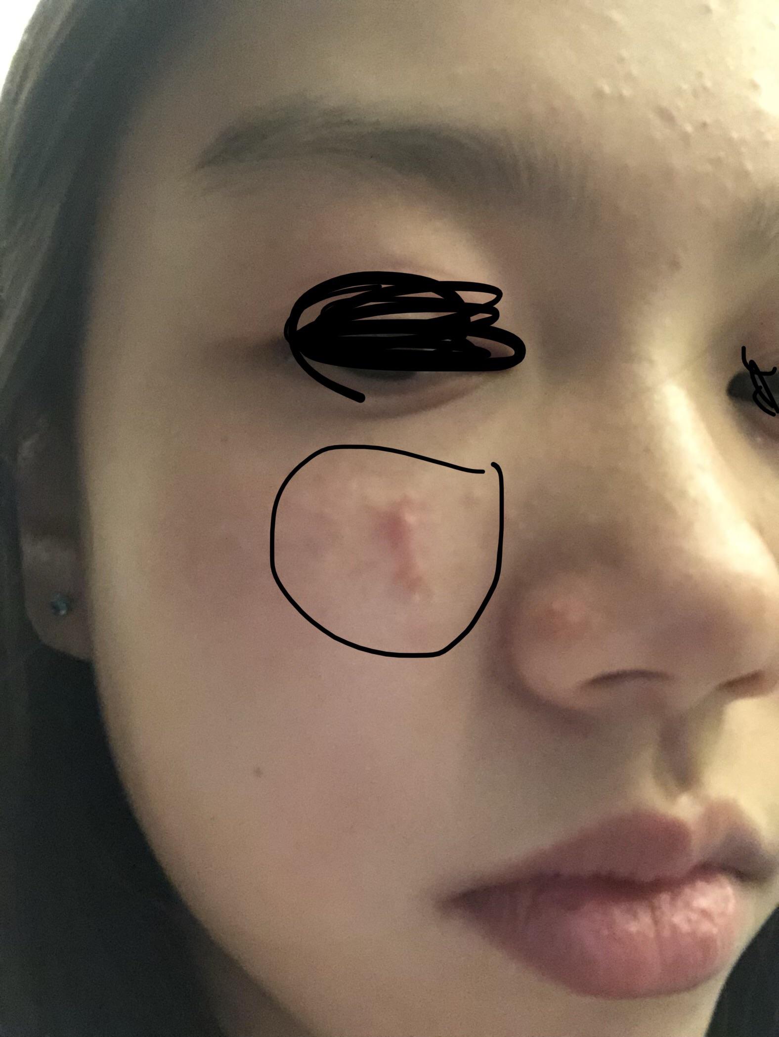 bumps under eyes wont go away? is this a pimple? | Scrolller