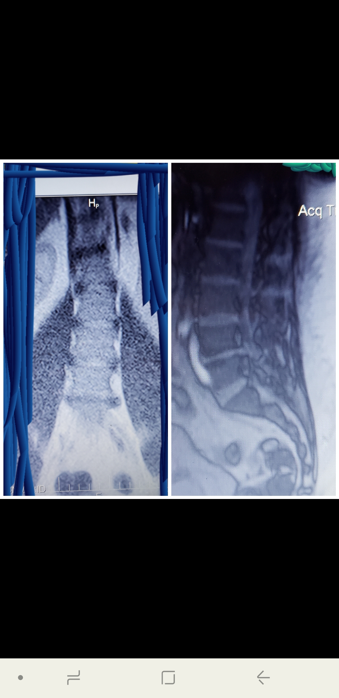 Can anyone read this? Lumbar MRI | Scrolller
