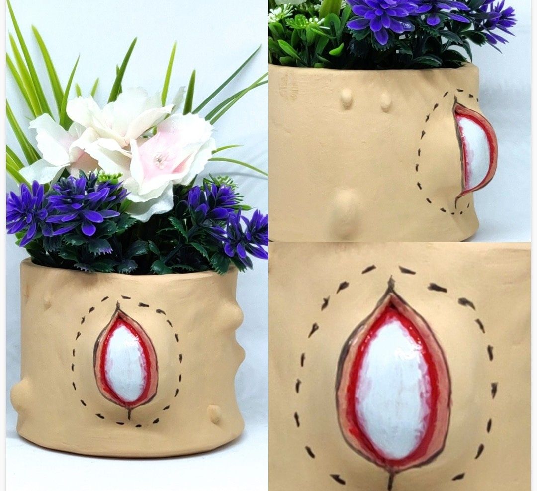 Cyst removal operation plant pot anyone? | Scrolller