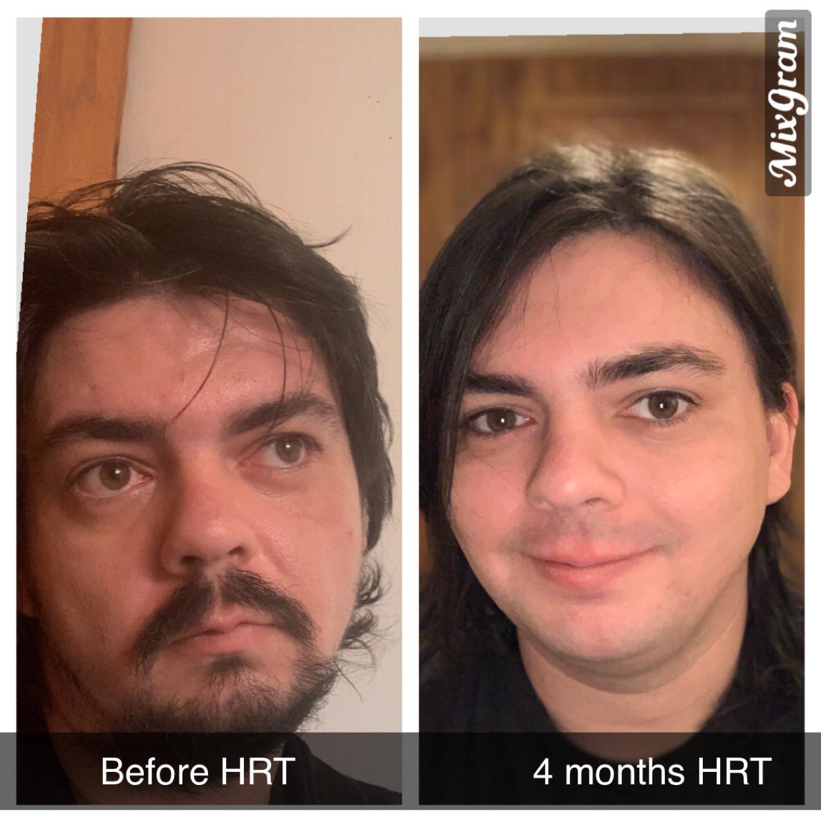 Face difference!!! X months before vs 4 months into HRT. I want to cry 😭 | Scrolller