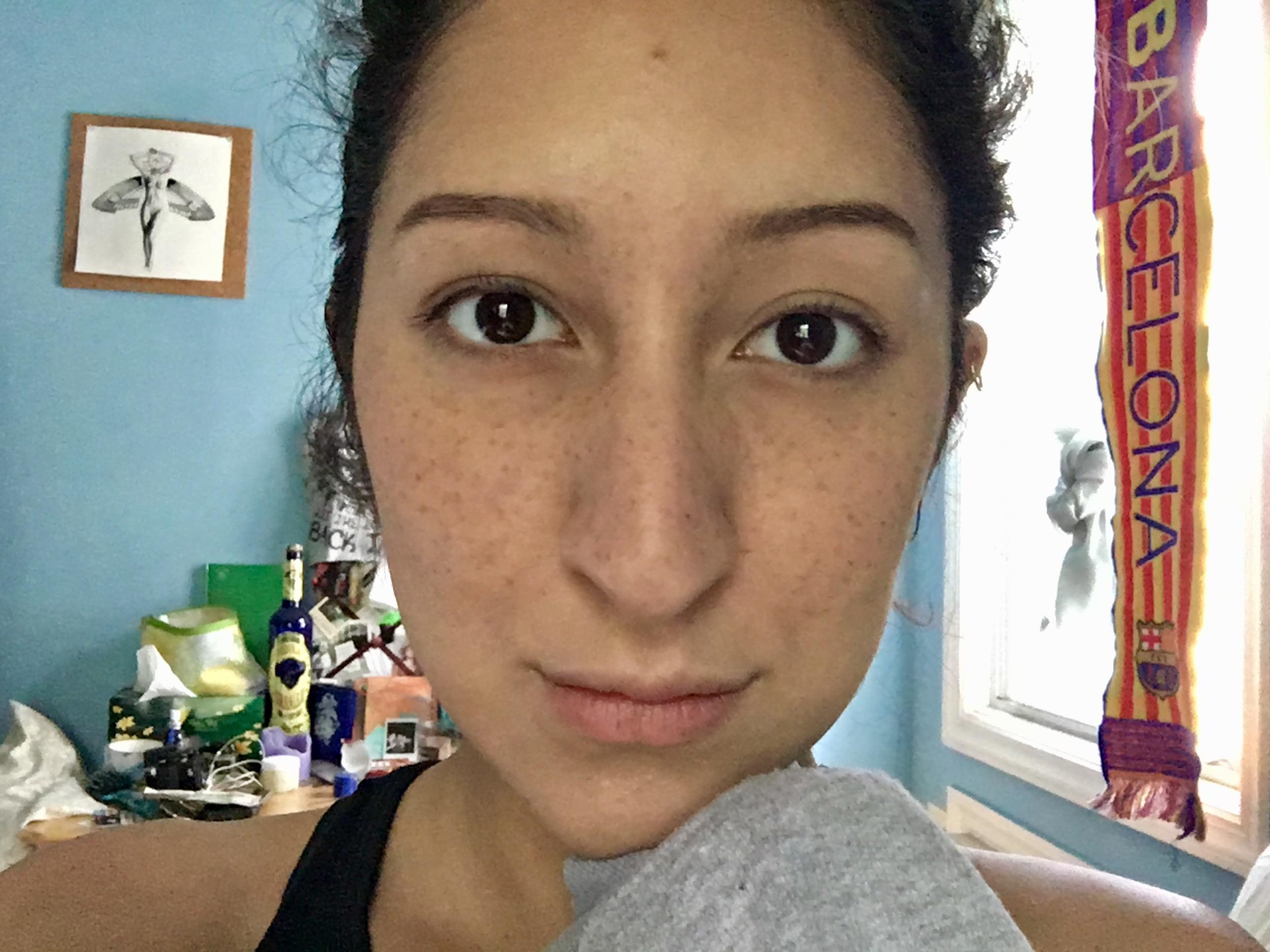 Faux freckles over my acne scars! | Scrolller