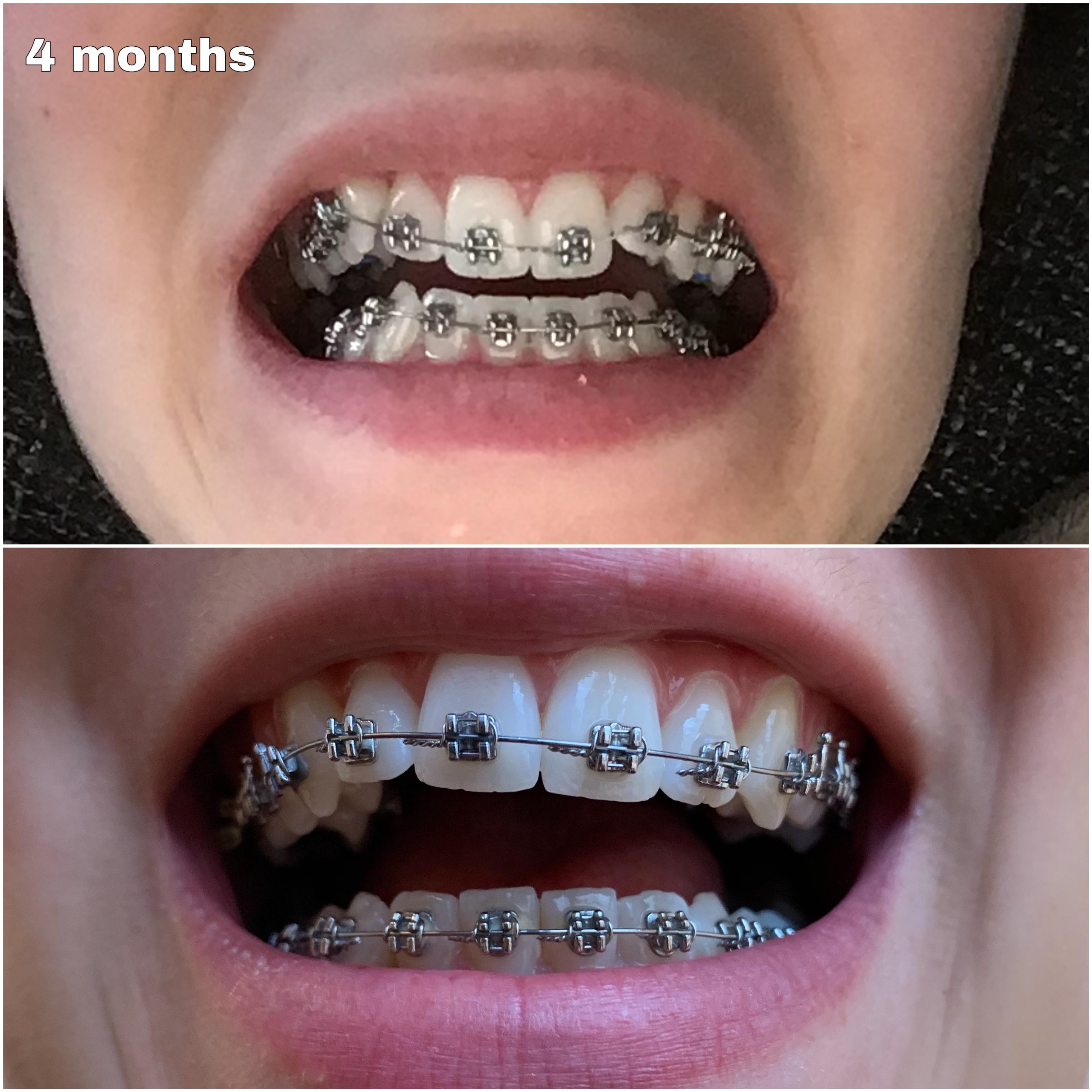 Finally my two front teeth stopped lookin that big | Scrolller