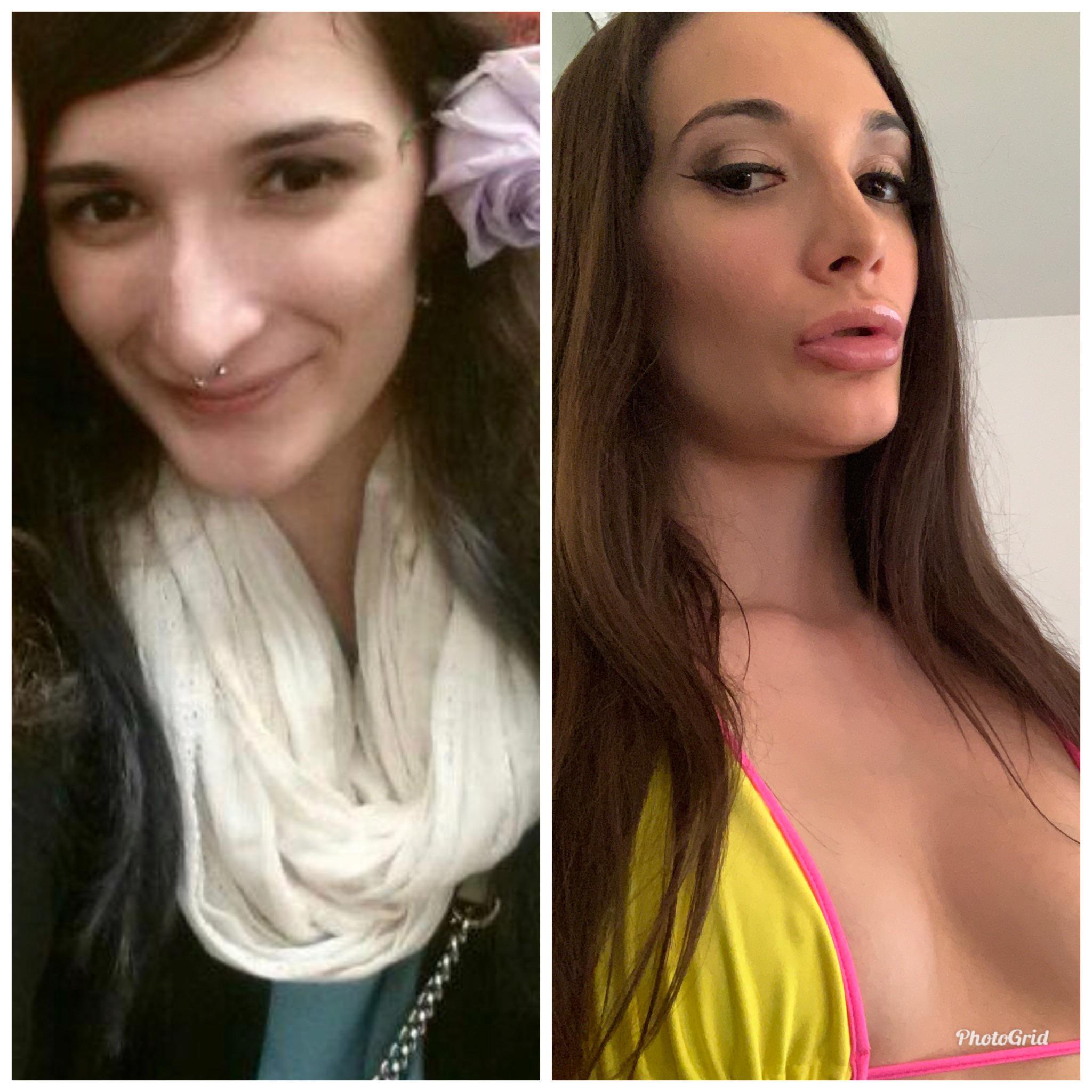 First time poster. My progress over the years. I’ve had a nose job, been getting lip injections ...